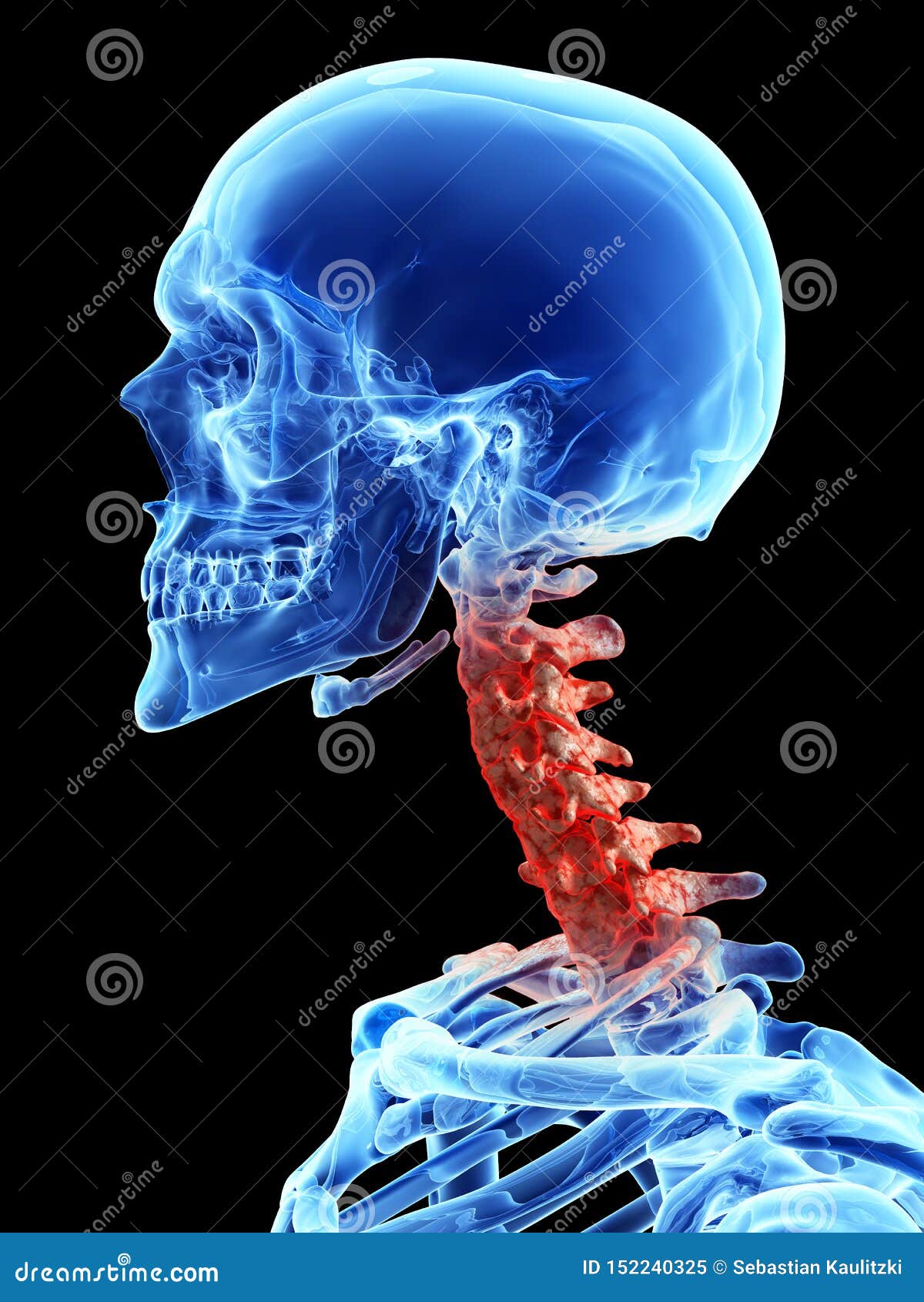 Arthrosis In The Cervical Spine Royalty-Free Illustration ...