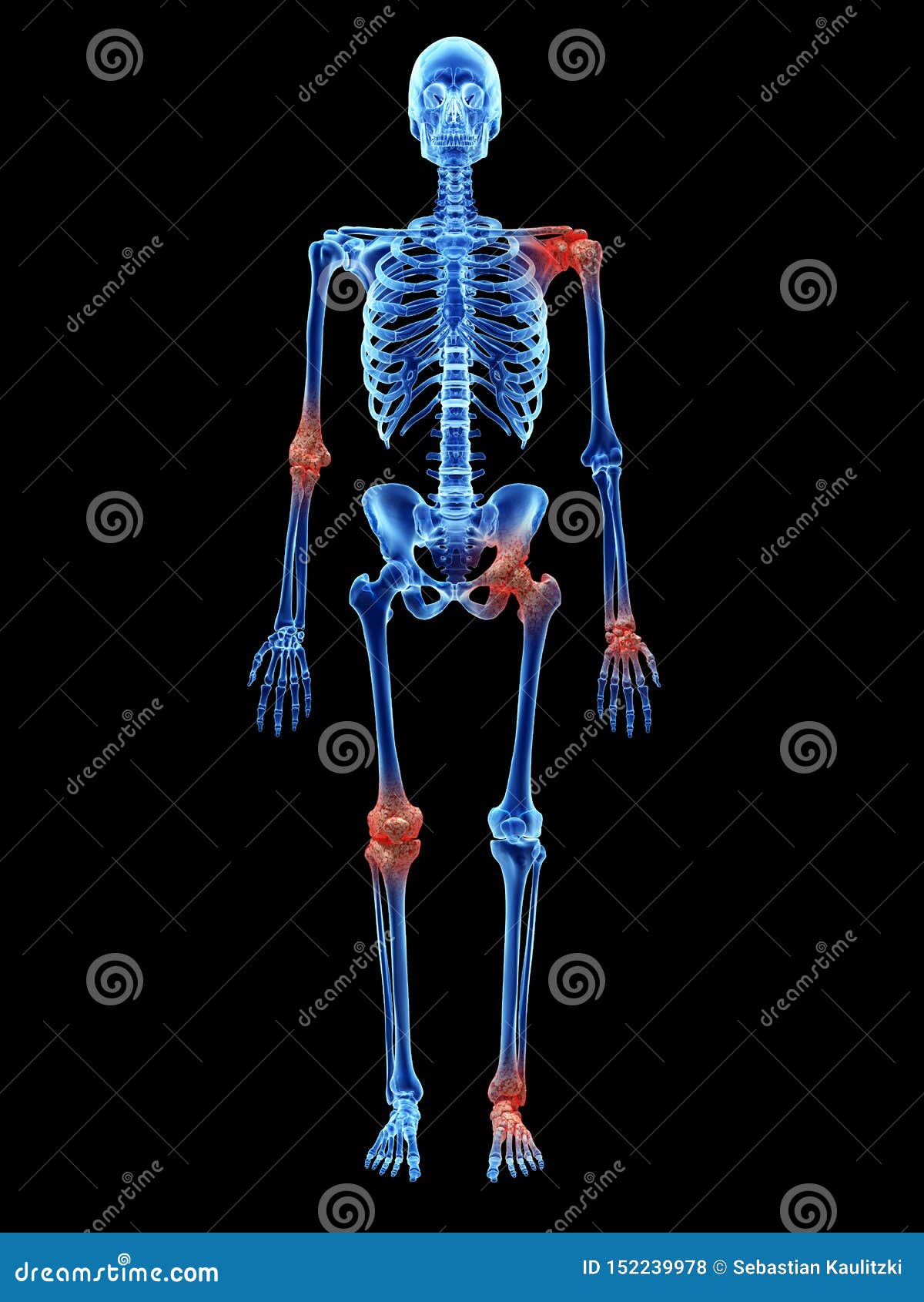 Arthrosis Medical Vector Illustration Diagram With Damaged Knee ...