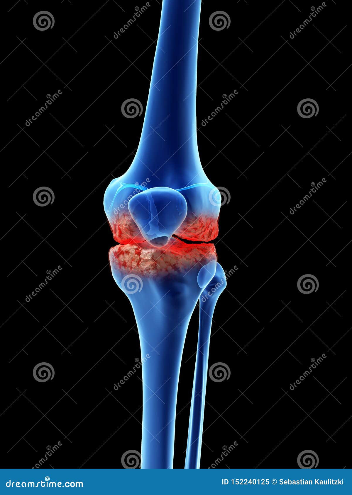Knee Arthrosis. Unhealthy Knee Structure. Bone Exposure, Damaged Knee ...