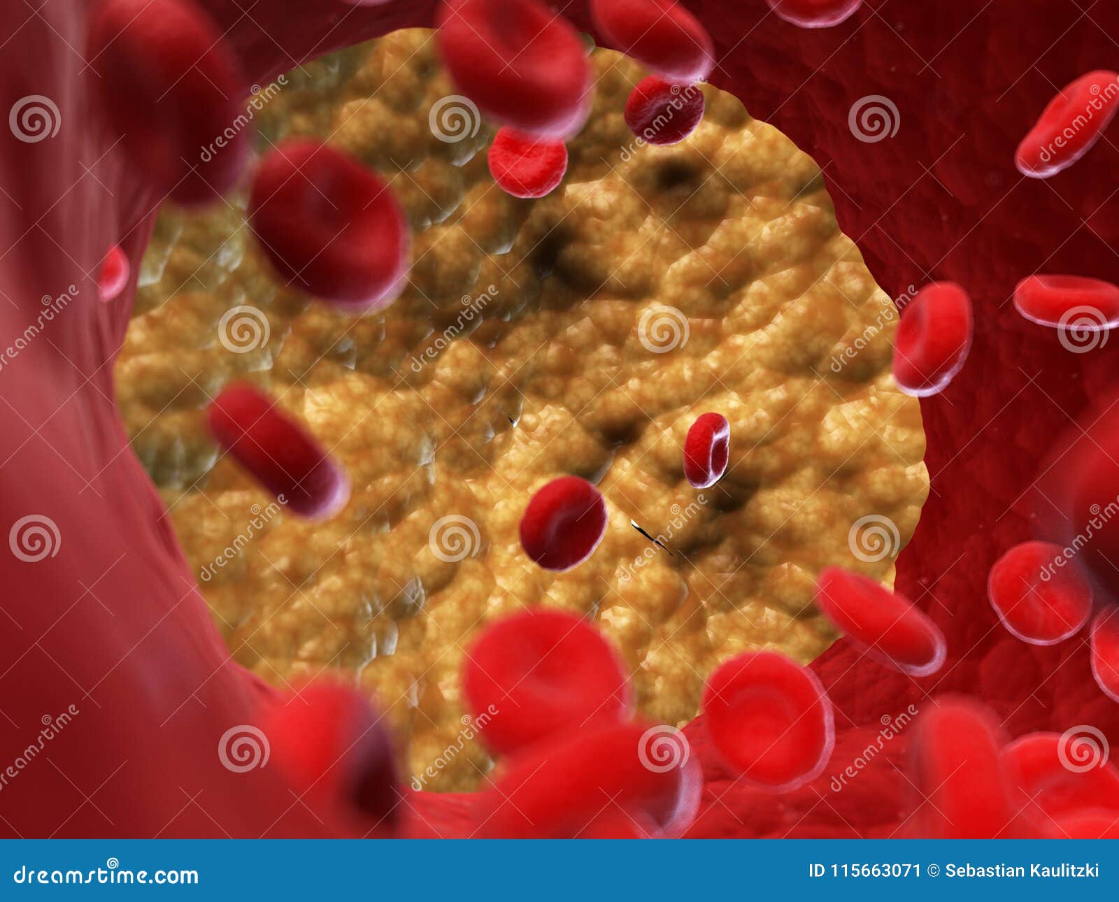 Blocked Artery, Collapsed Balloon Angioplasty Procedure With Coronary ...