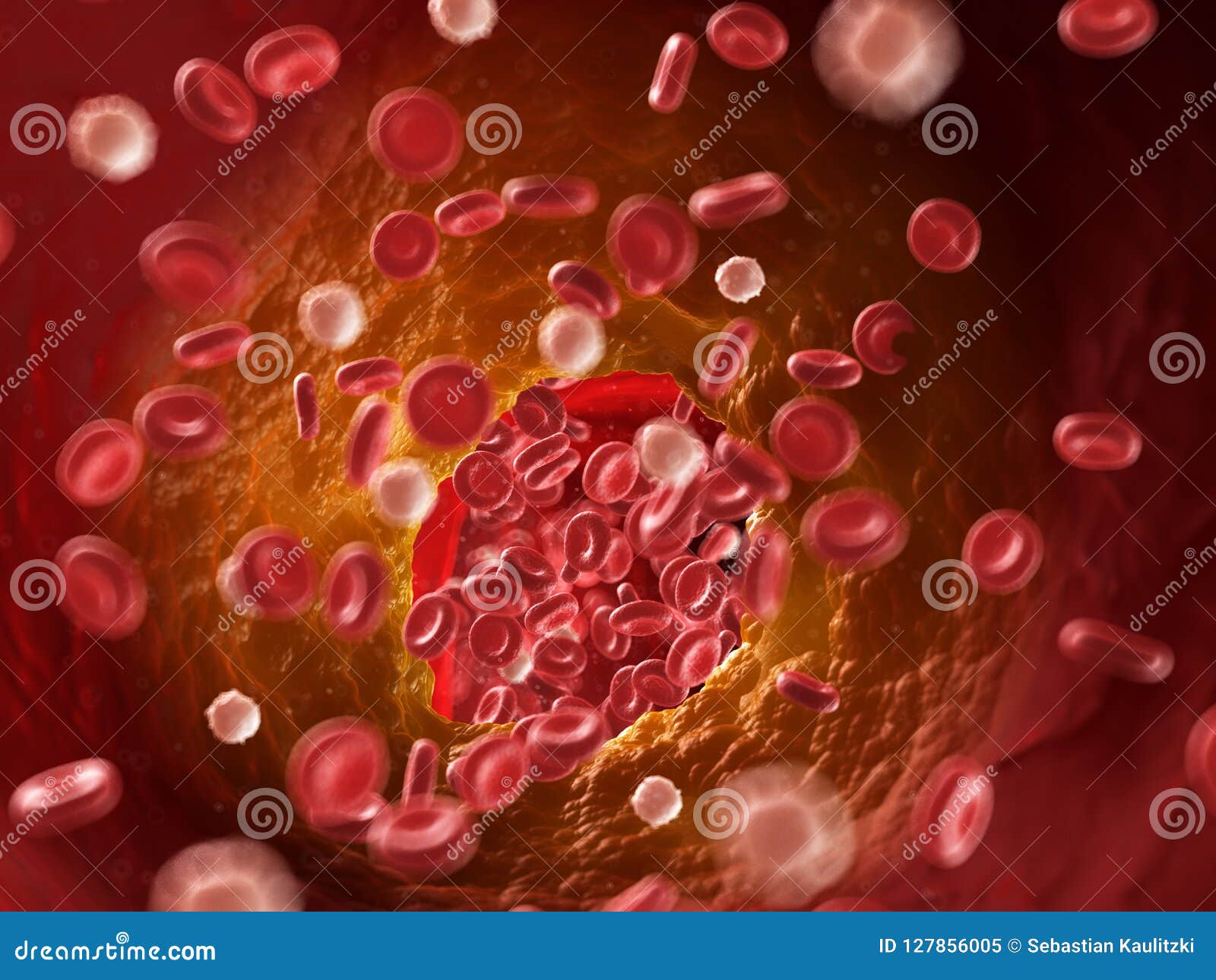 A blocked artery stock illustration. Illustration of cardiology - 127856005