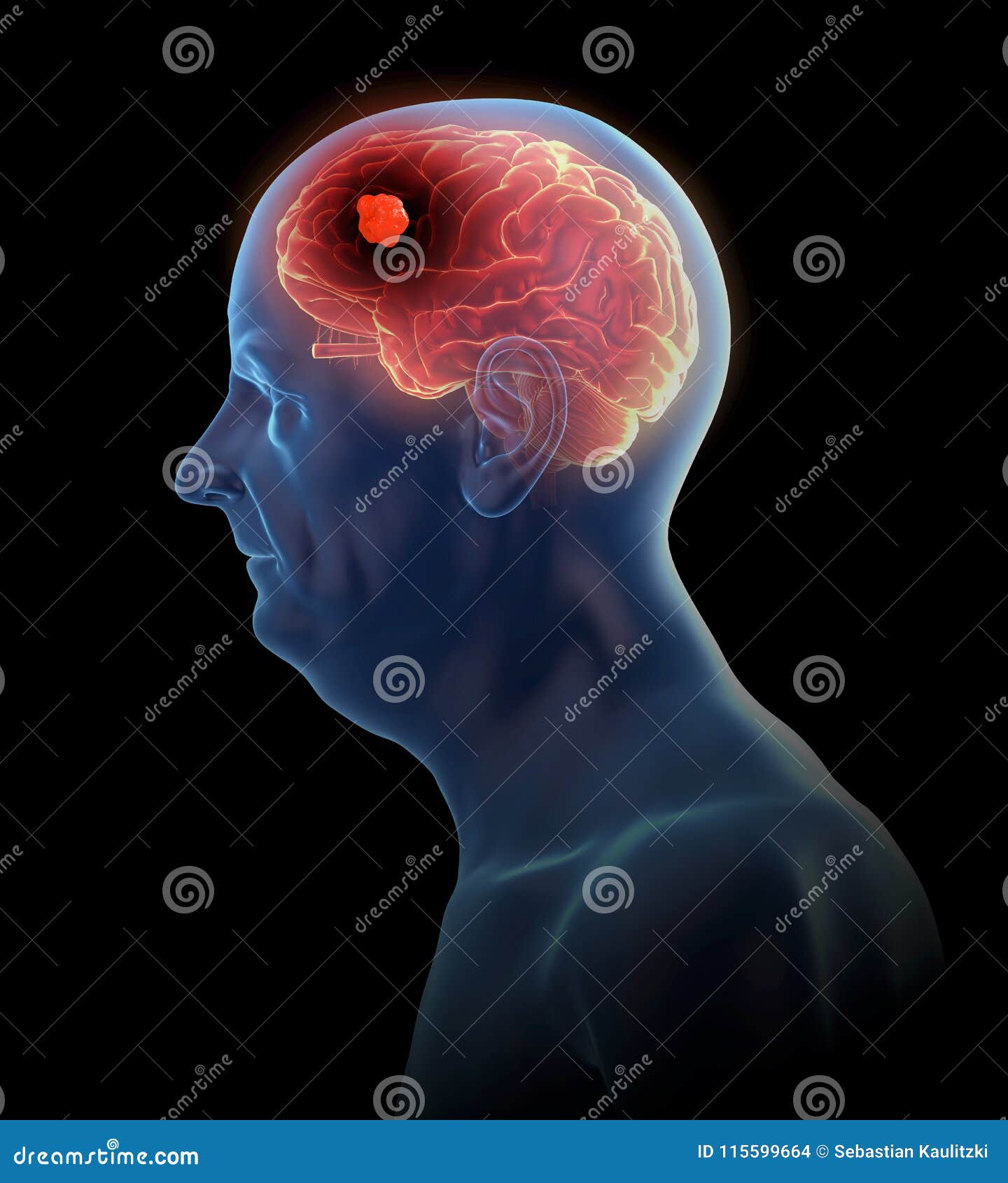 A brain tumor stock illustration. Illustration of senile - 115599664