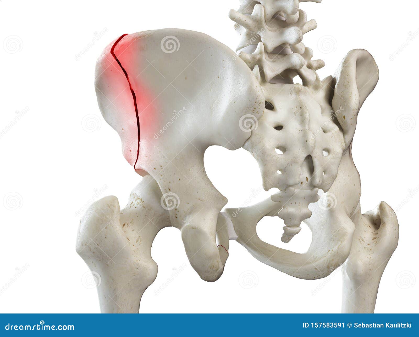 A broken pelvis stock illustration. Illustration of science - 157583591