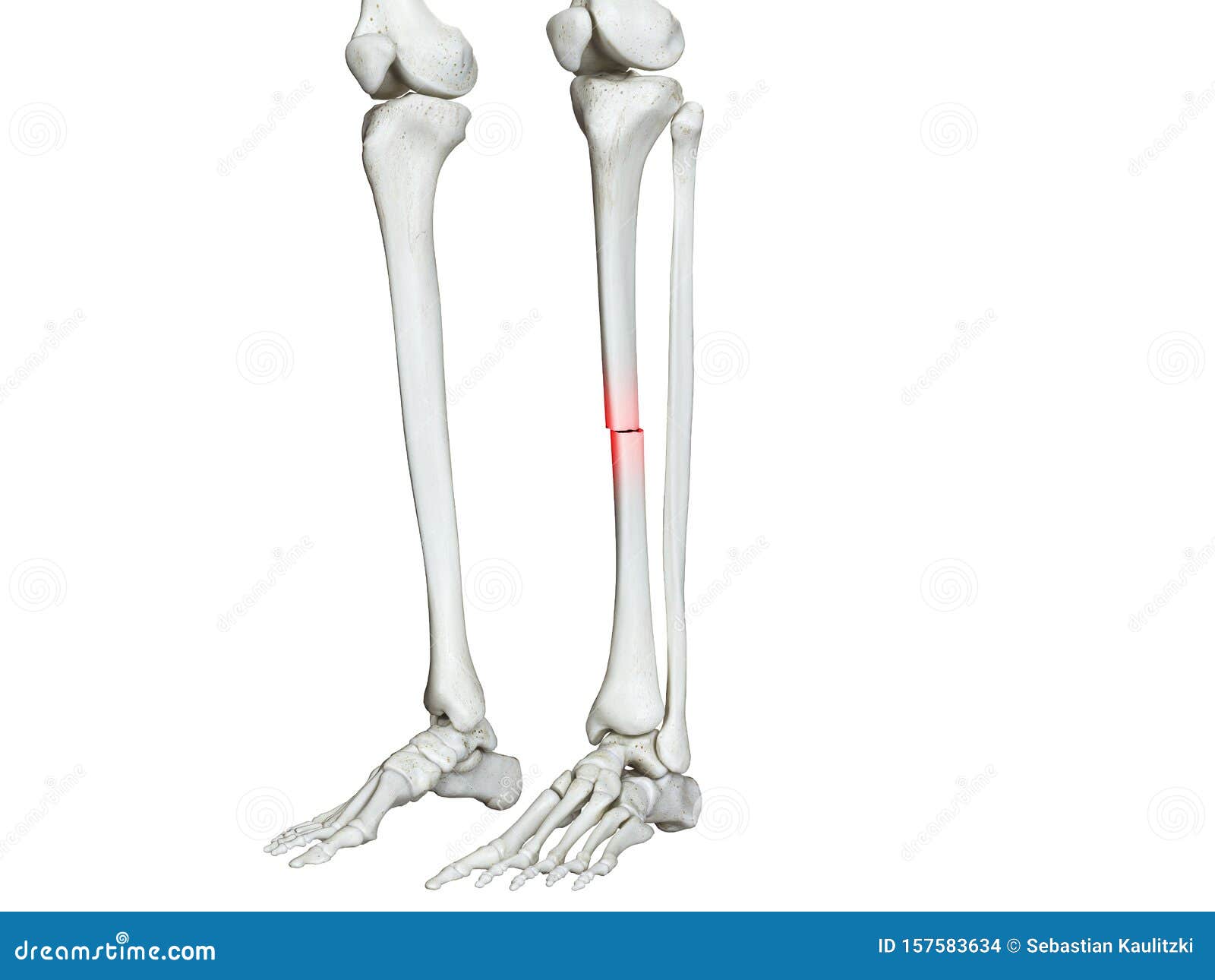 A broken tibia stock illustration. Illustration of bones - 157583634