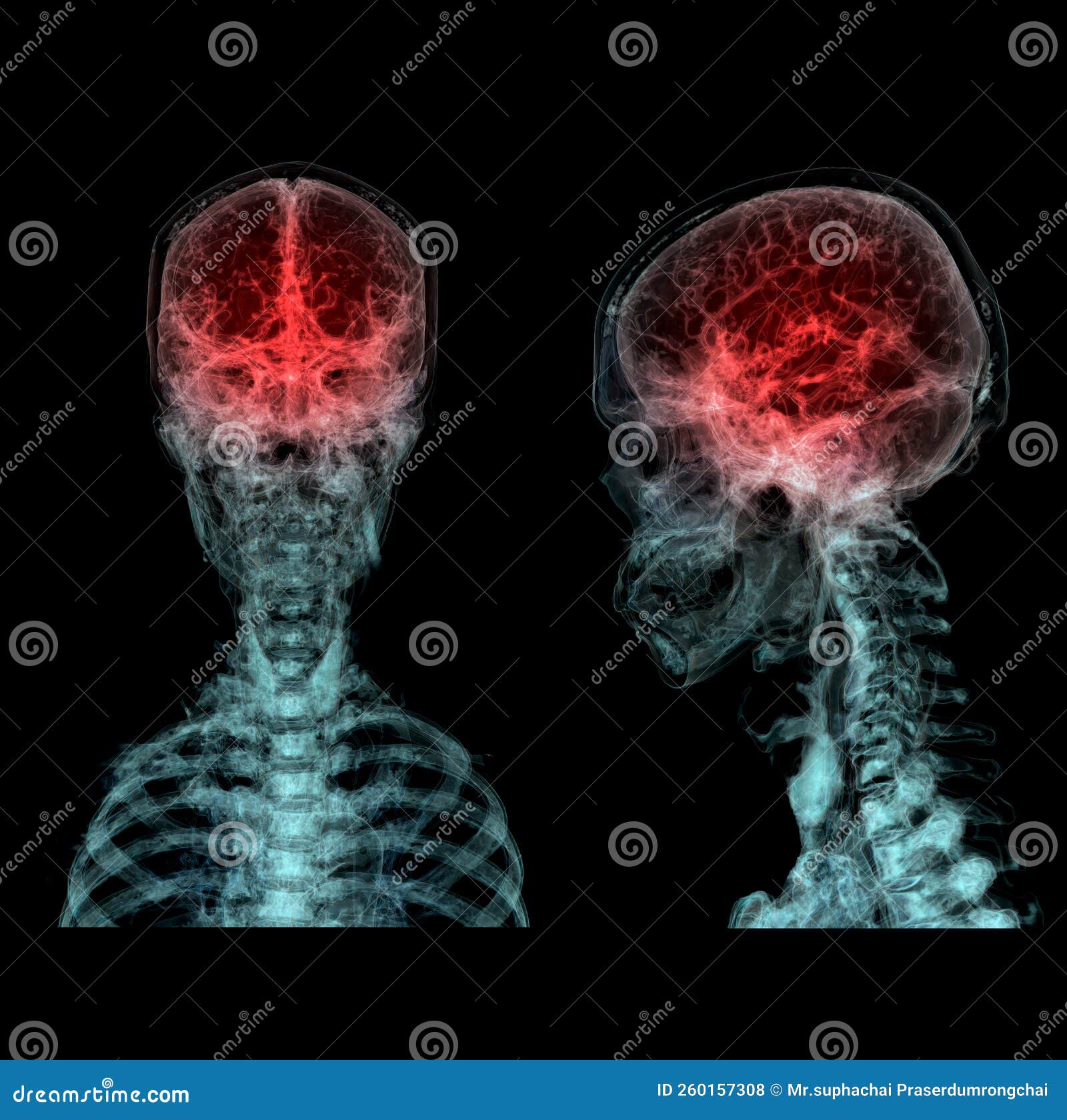 Cerebral Angiogram Blood Vessel Visualization Royalty-Free Stock Image ...
