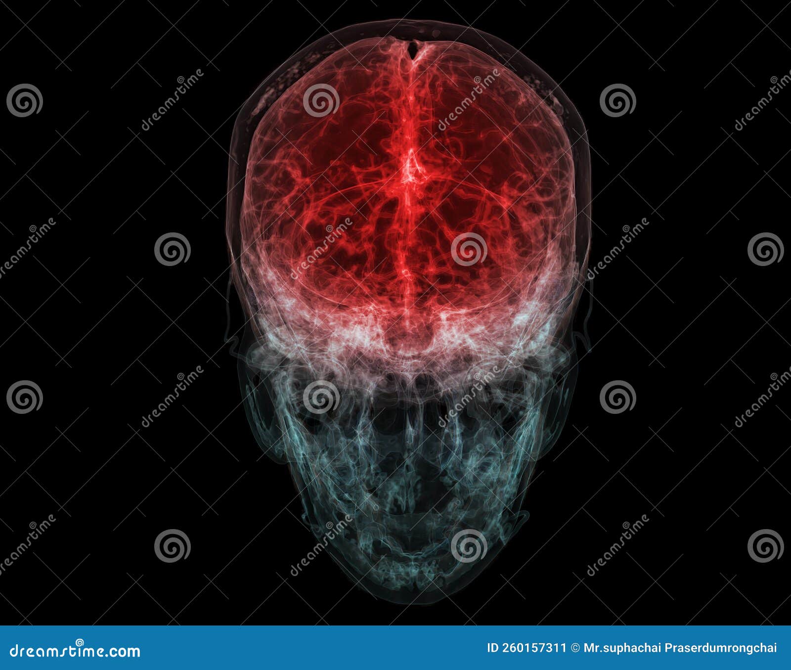 Cerebral Angiogram Blood Vessel Visualization Royalty-Free Stock Image ...