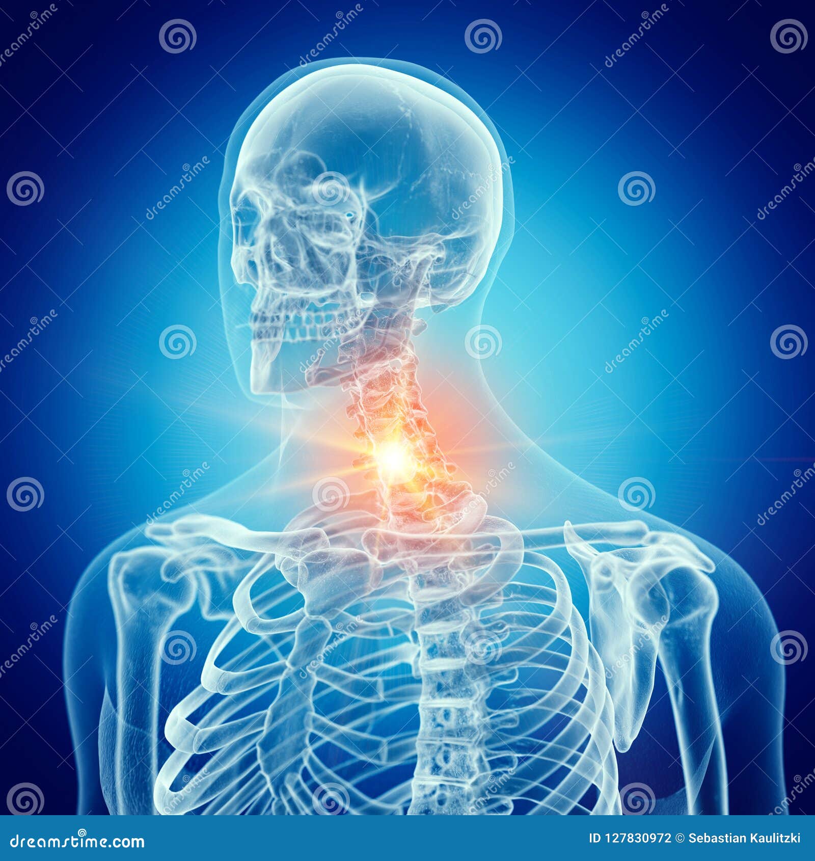 Arthrosis In The Cervical Spine Royalty-Free Illustration ...