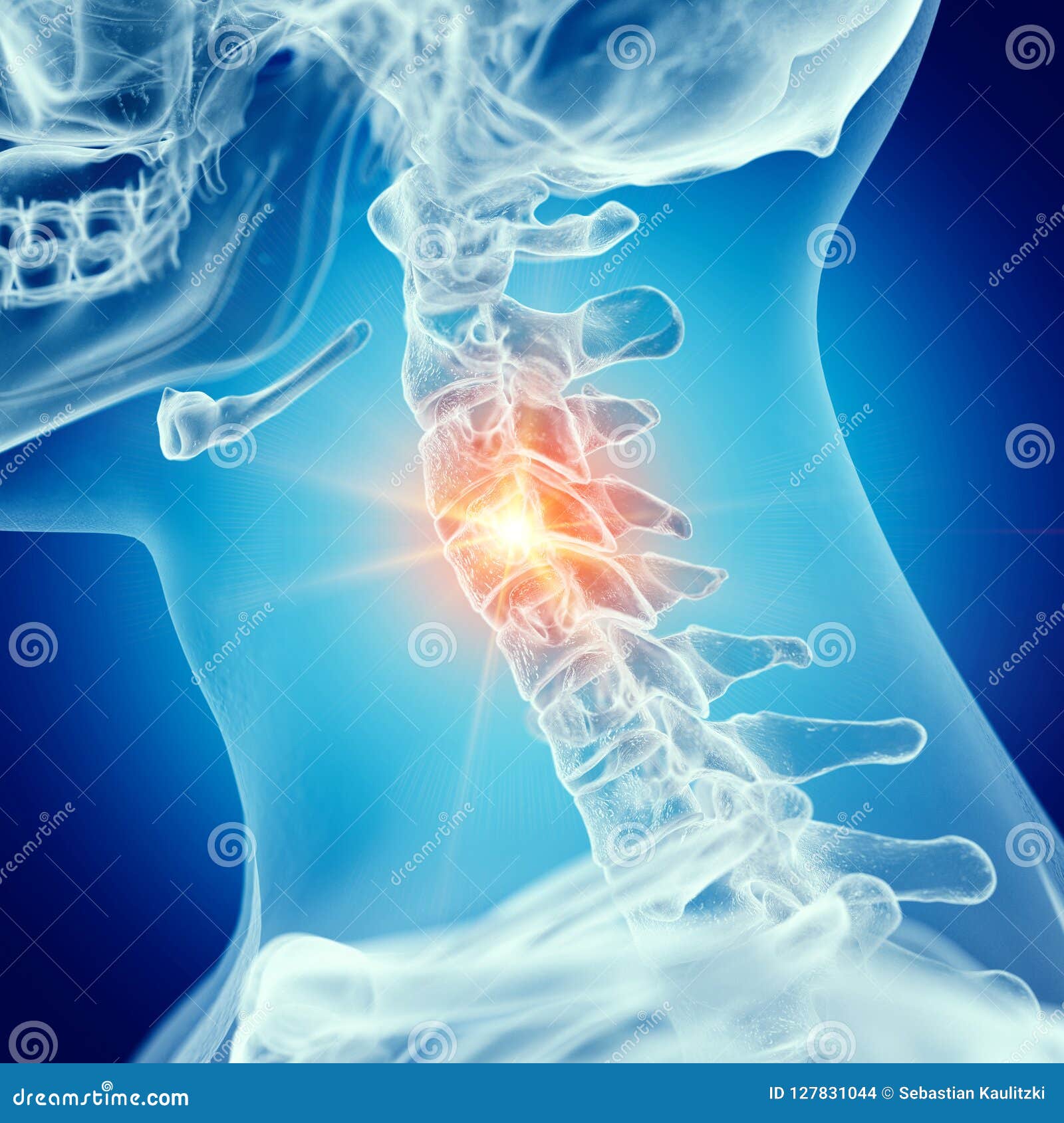 The cervical spine stock illustration. Illustration of arthritis ...