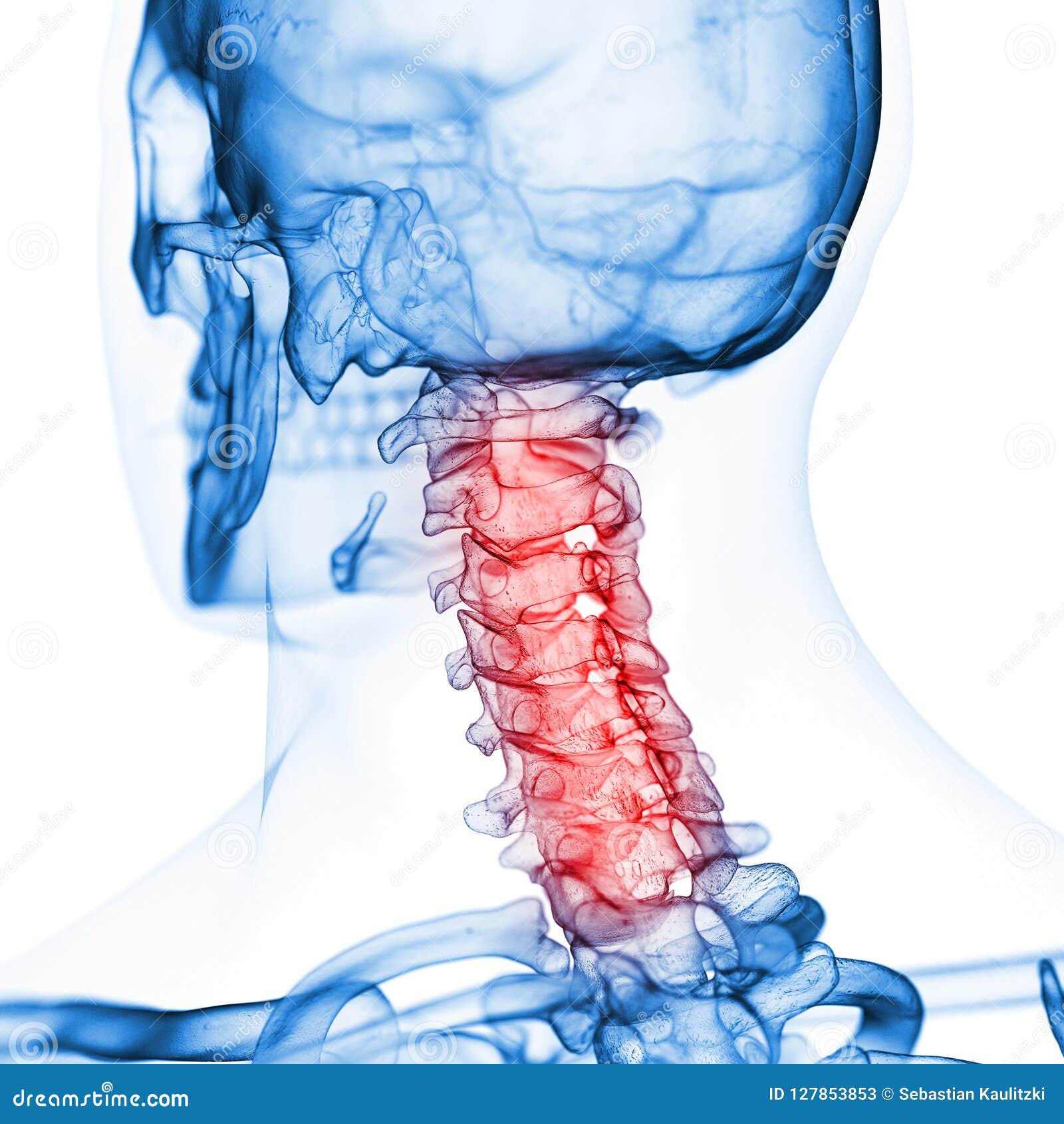 Arthrosis In The Cervical Spine Royalty-Free Illustration ...