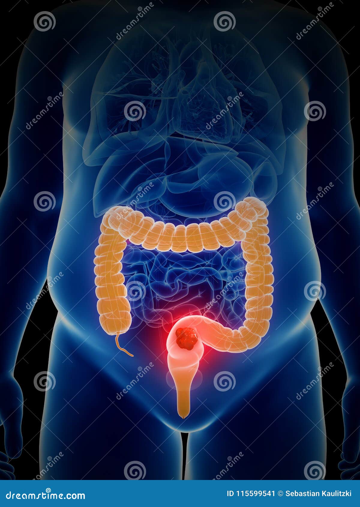 Colon Cancer Stock Illustration Illustration Of Body 115599541