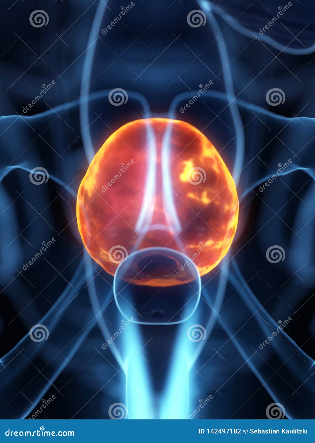 A diseased bladder stock illustration. Illustration of disease - 142497182