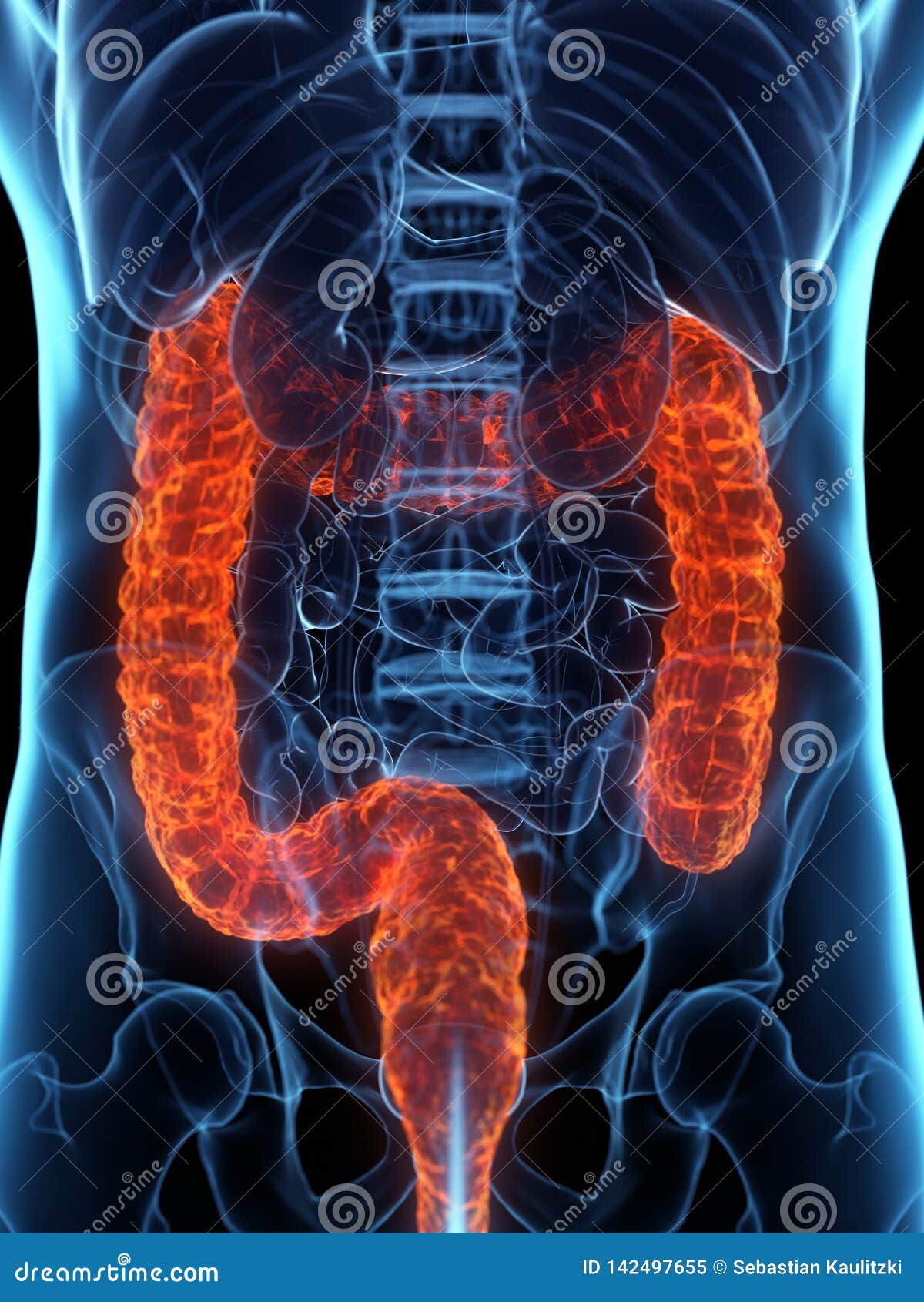 A diseased colon stock illustration. Illustration of anatomy - 142497655