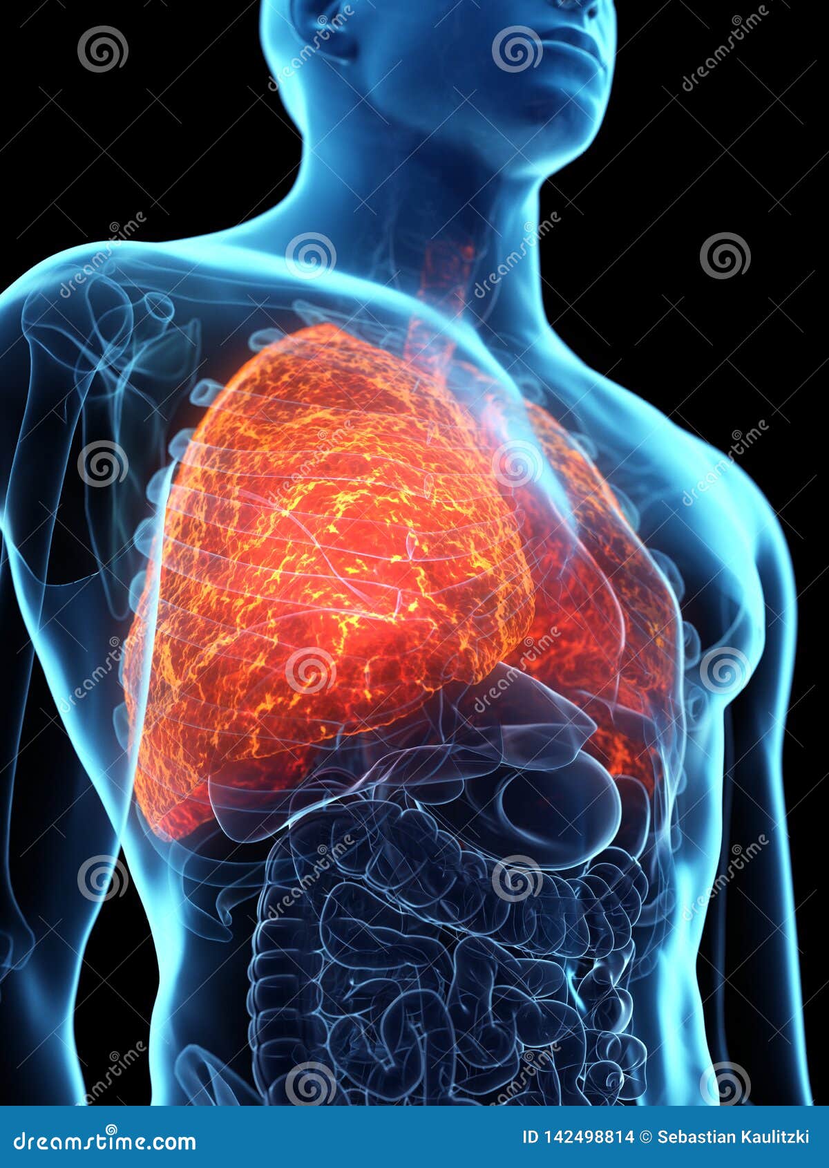 Pneumoconiosis And Painful Human Condition, Pictured As A Wooden Human ...