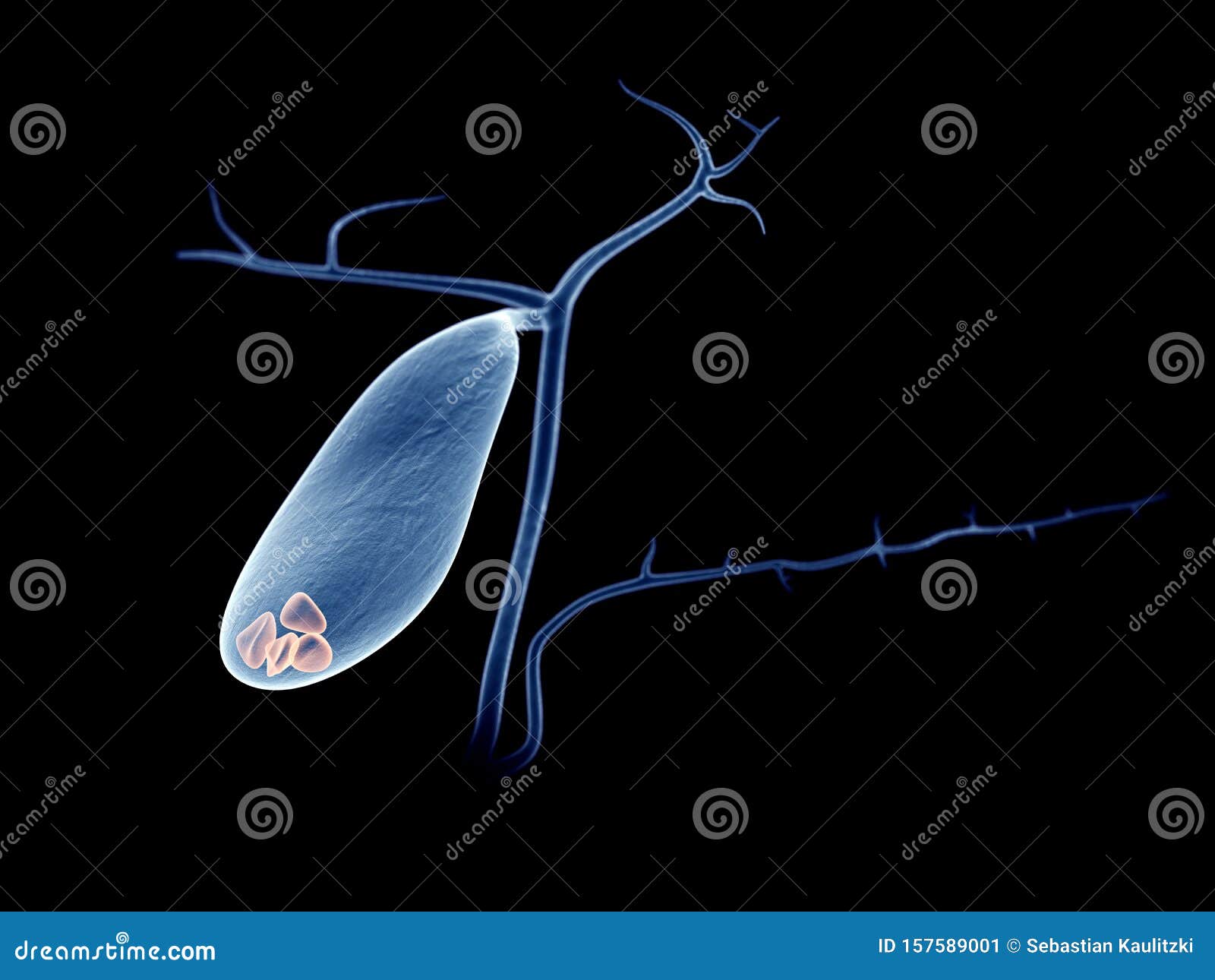 The Stones In The Gallbladder. Duodenum, Pancreas, Bile Ducts. Vector ...