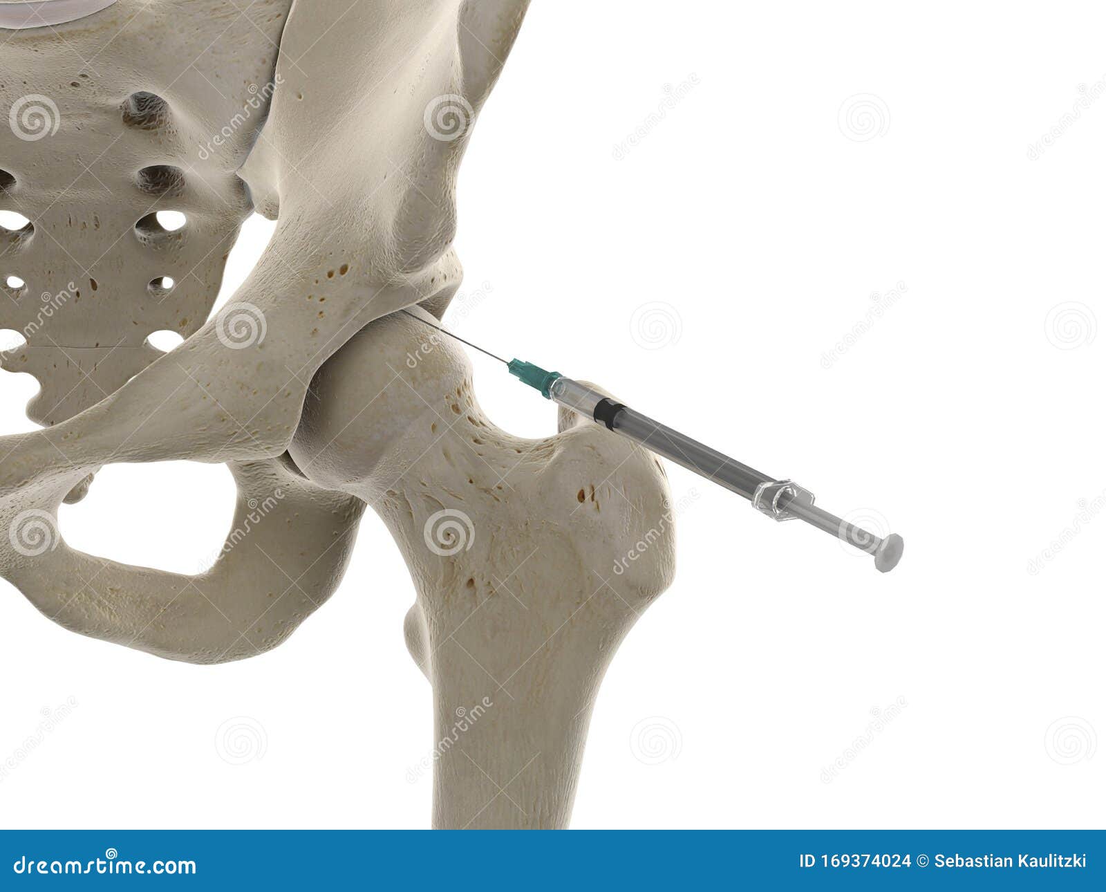A hip joint injection stock illustration. Illustration of graphic ...