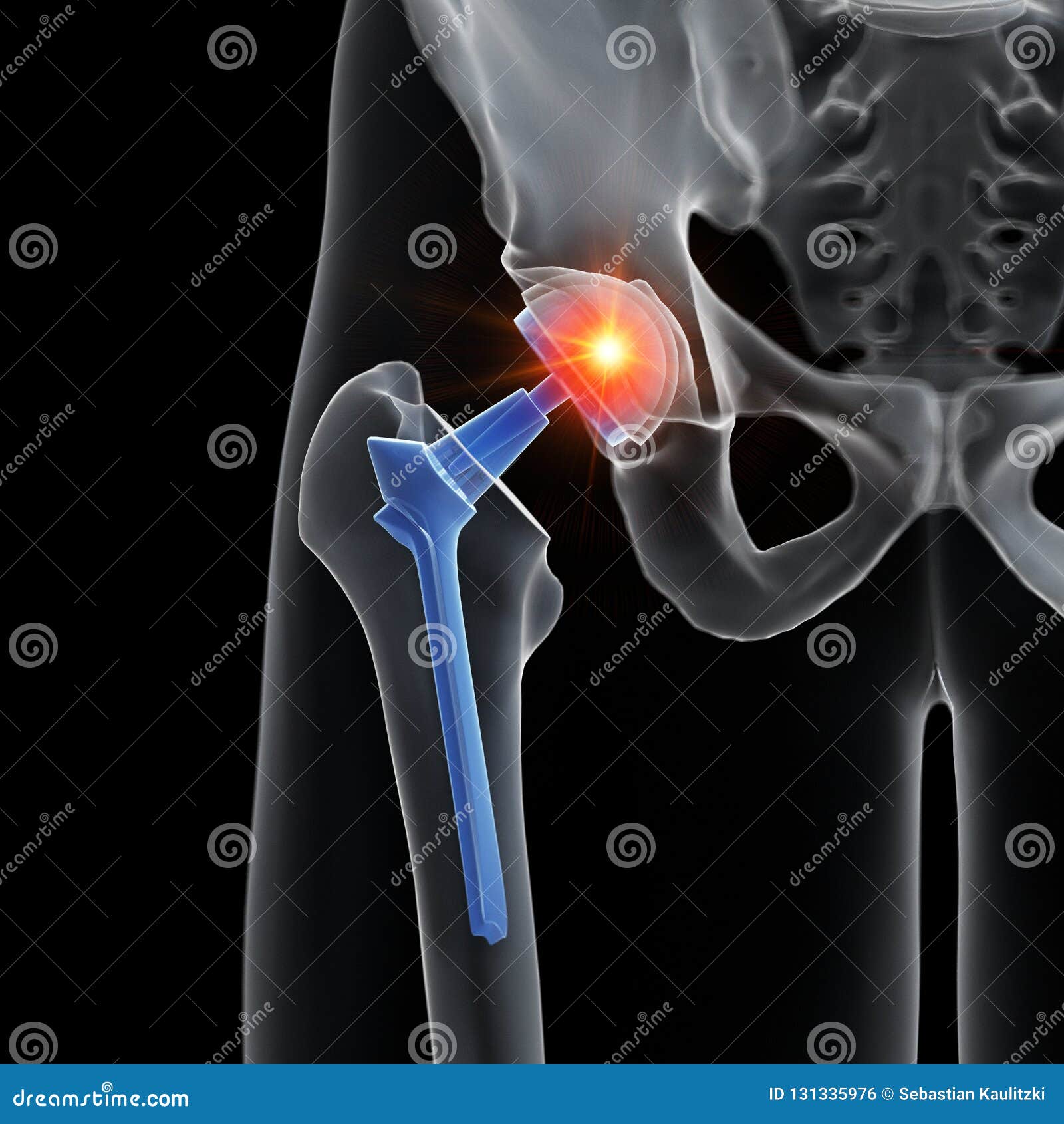 A hip replacement stock illustration. Illustration of medically - 131335976
