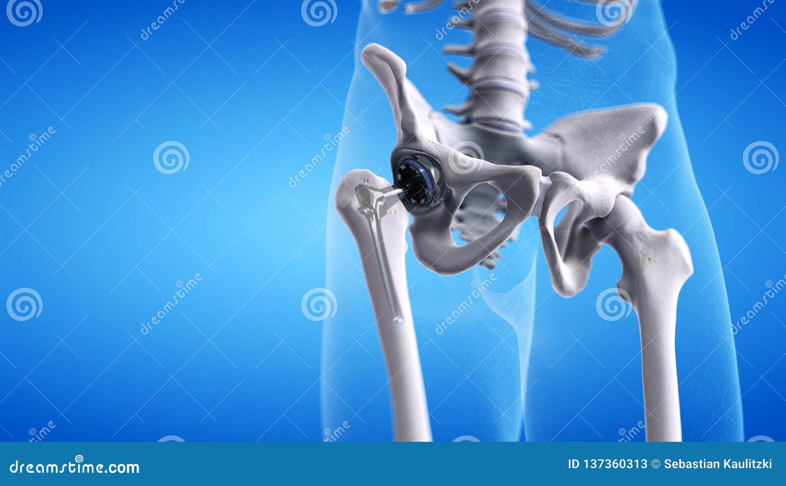 A hip replacement stock illustration. Illustration of prosthetics ...