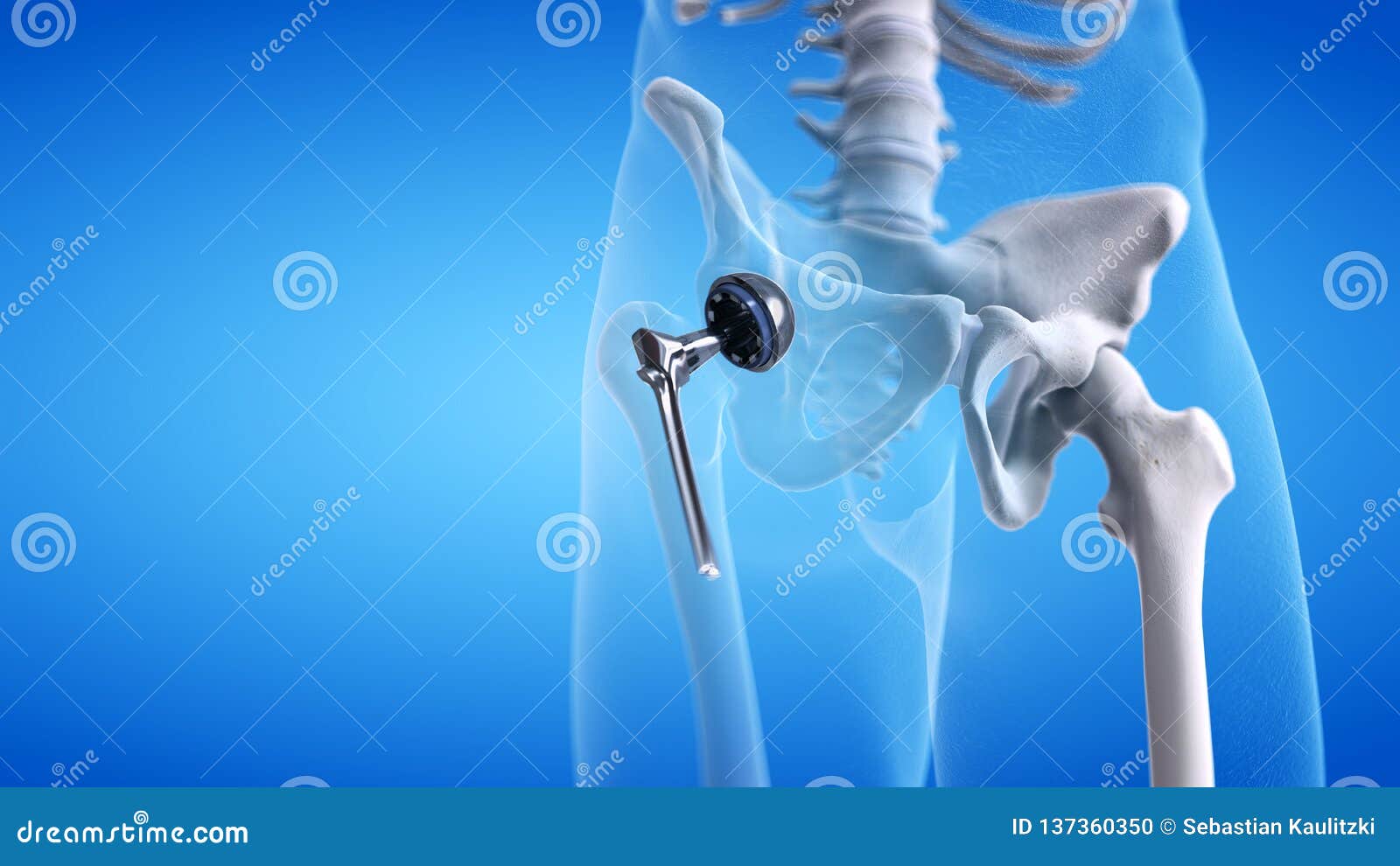 A hip replacement stock illustration. Illustration of rendering - 137360350