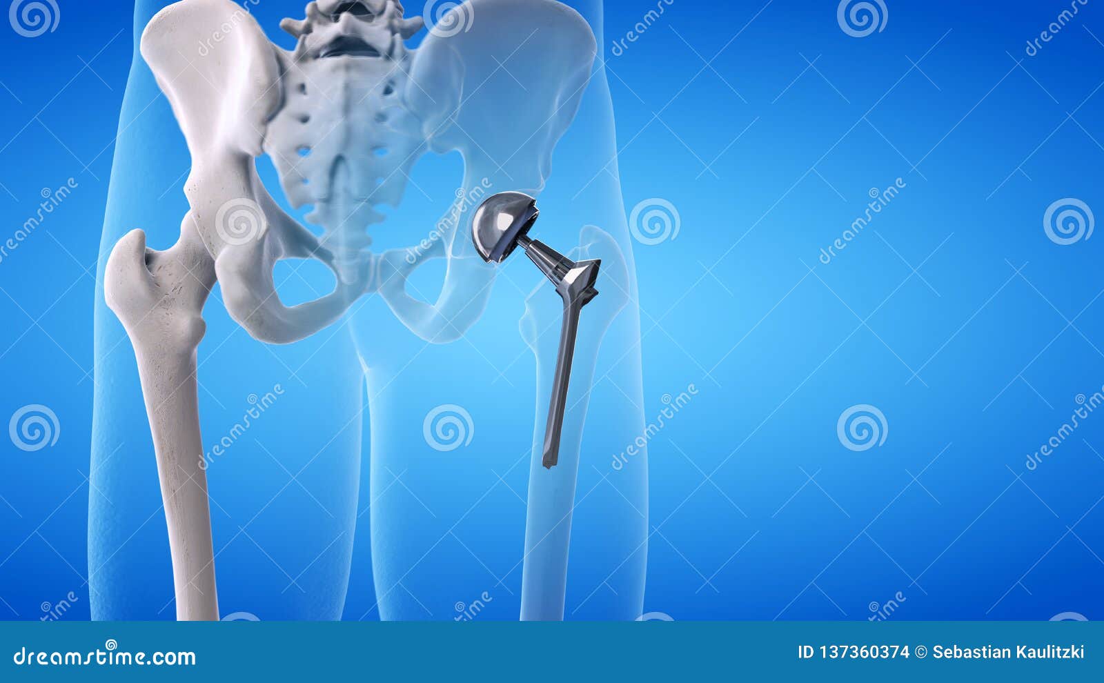 A hip replacement stock illustration. Illustration of prosthetics ...