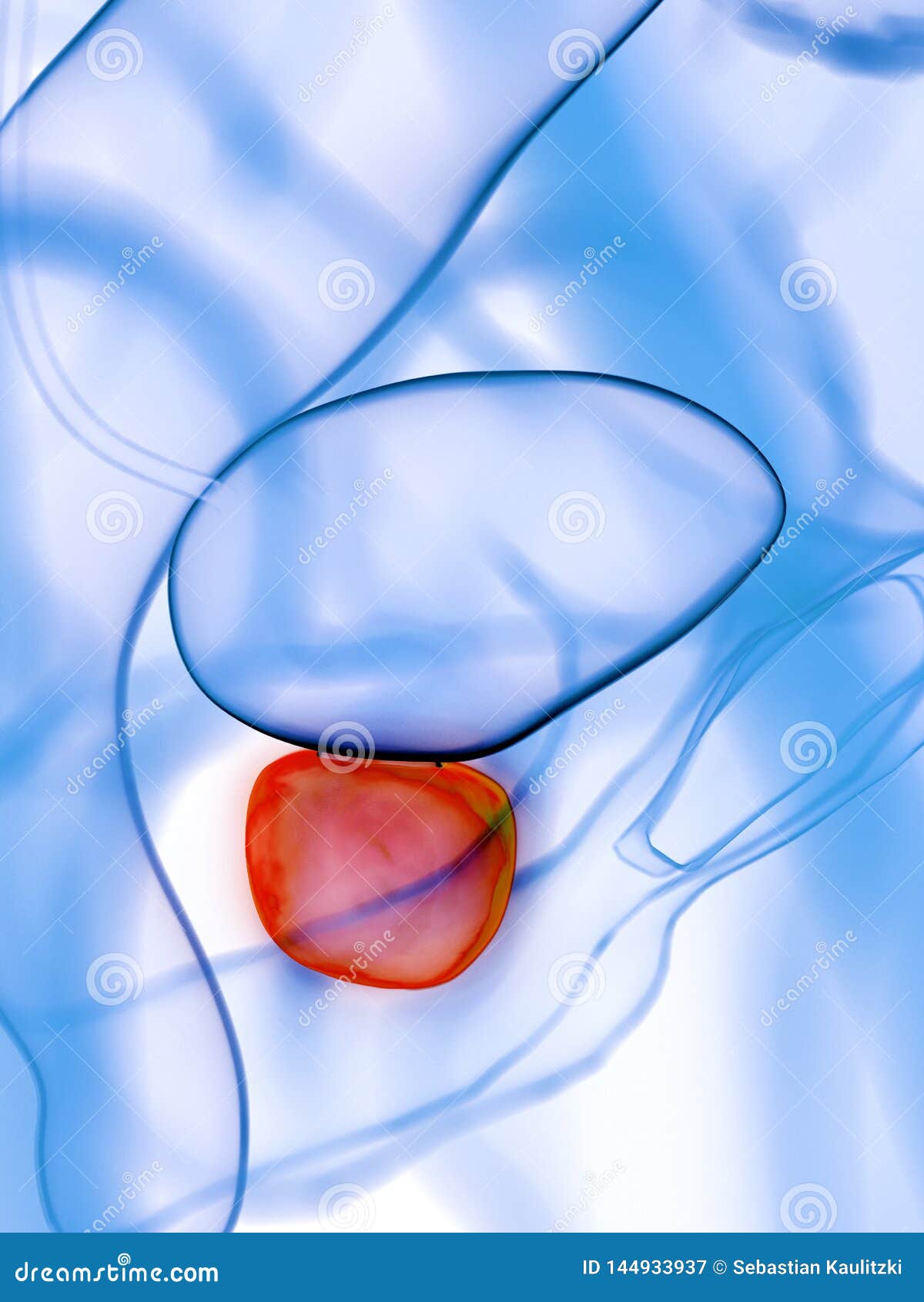 An inflamed prostate stock illustration. Illustration of injury - 144933937