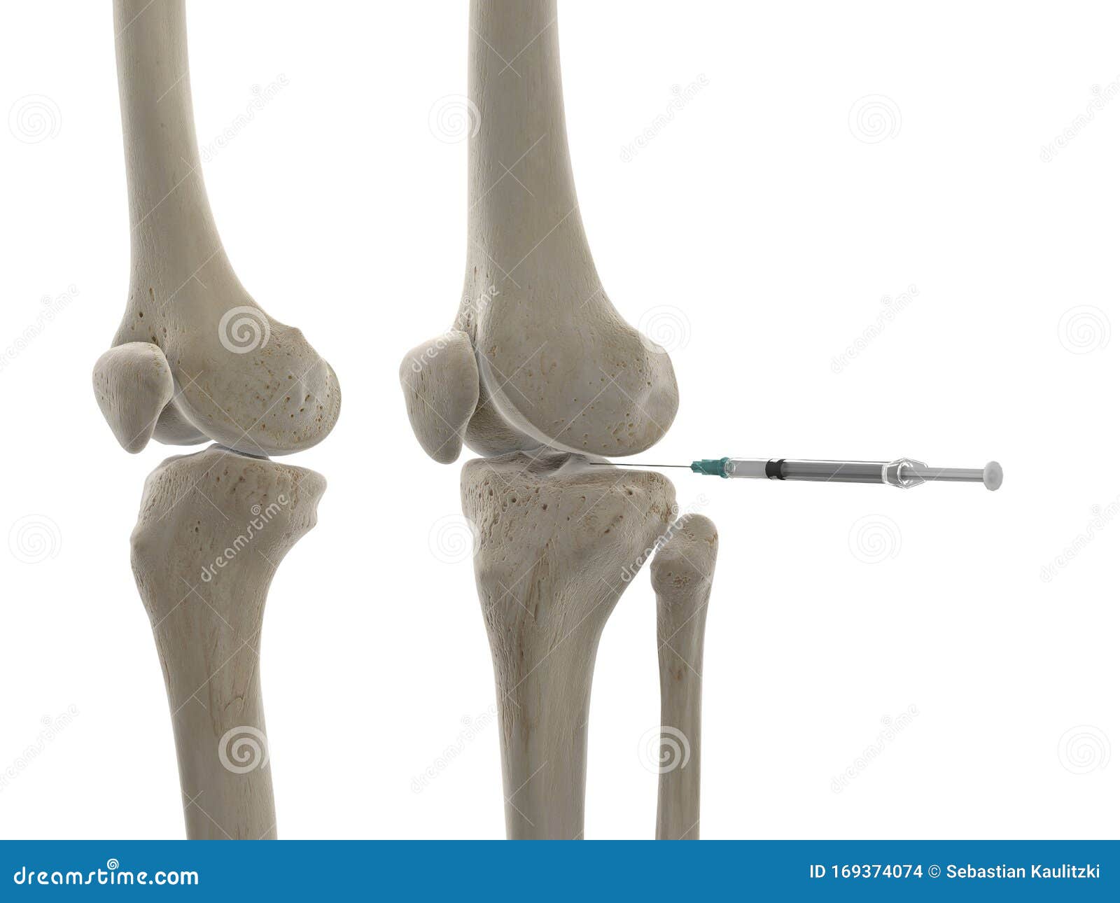 A knee joint injection stock illustration. Illustration of isolated ...