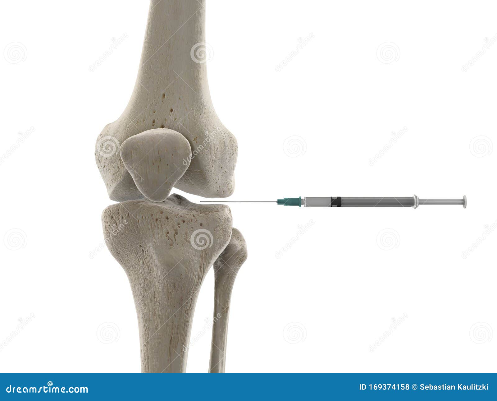 A knee joint injection stock illustration. Illustration of injection ...
