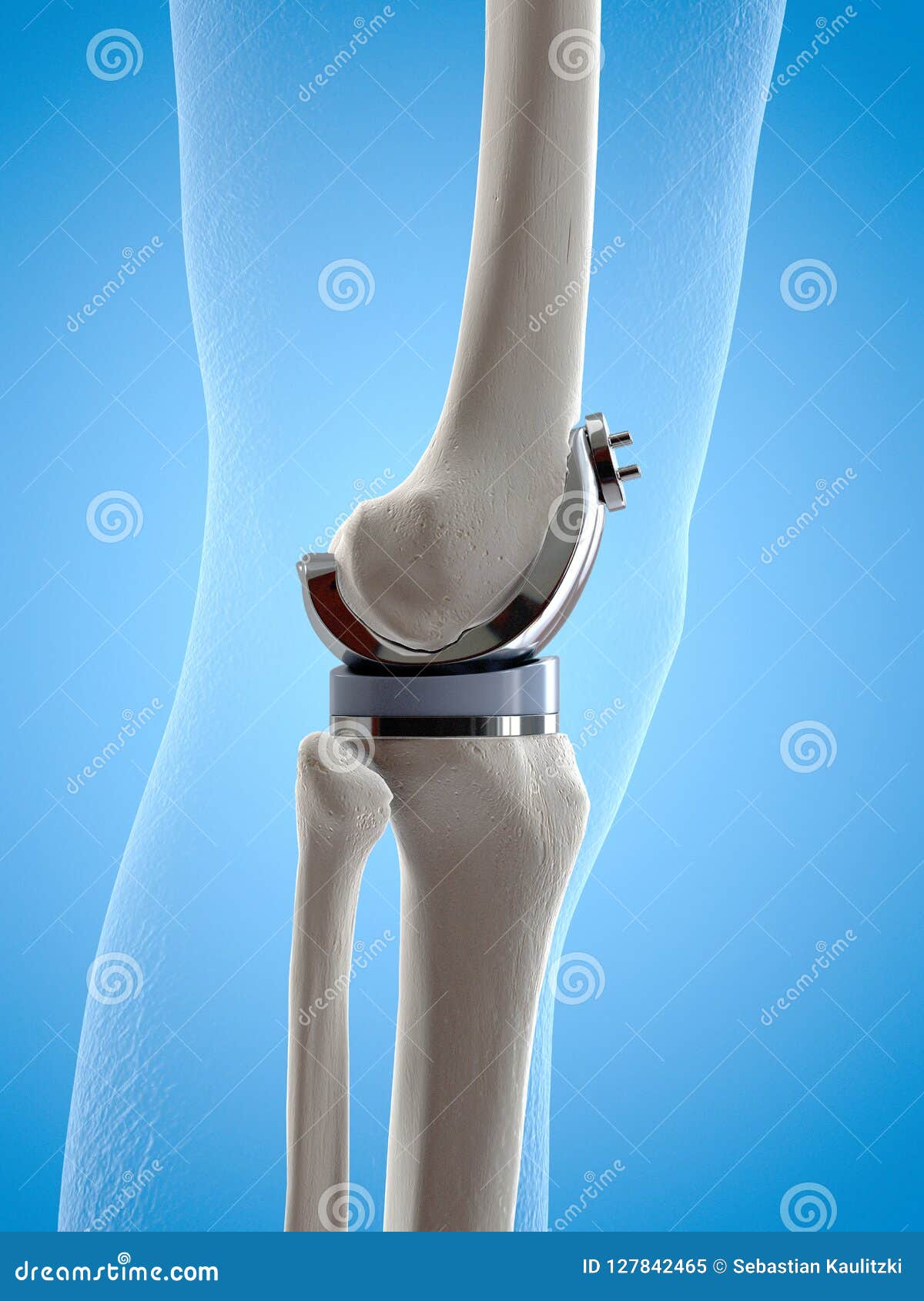Knee Replacement. Joint Prosthetics. Knee Endoprosthesis. Vector ...