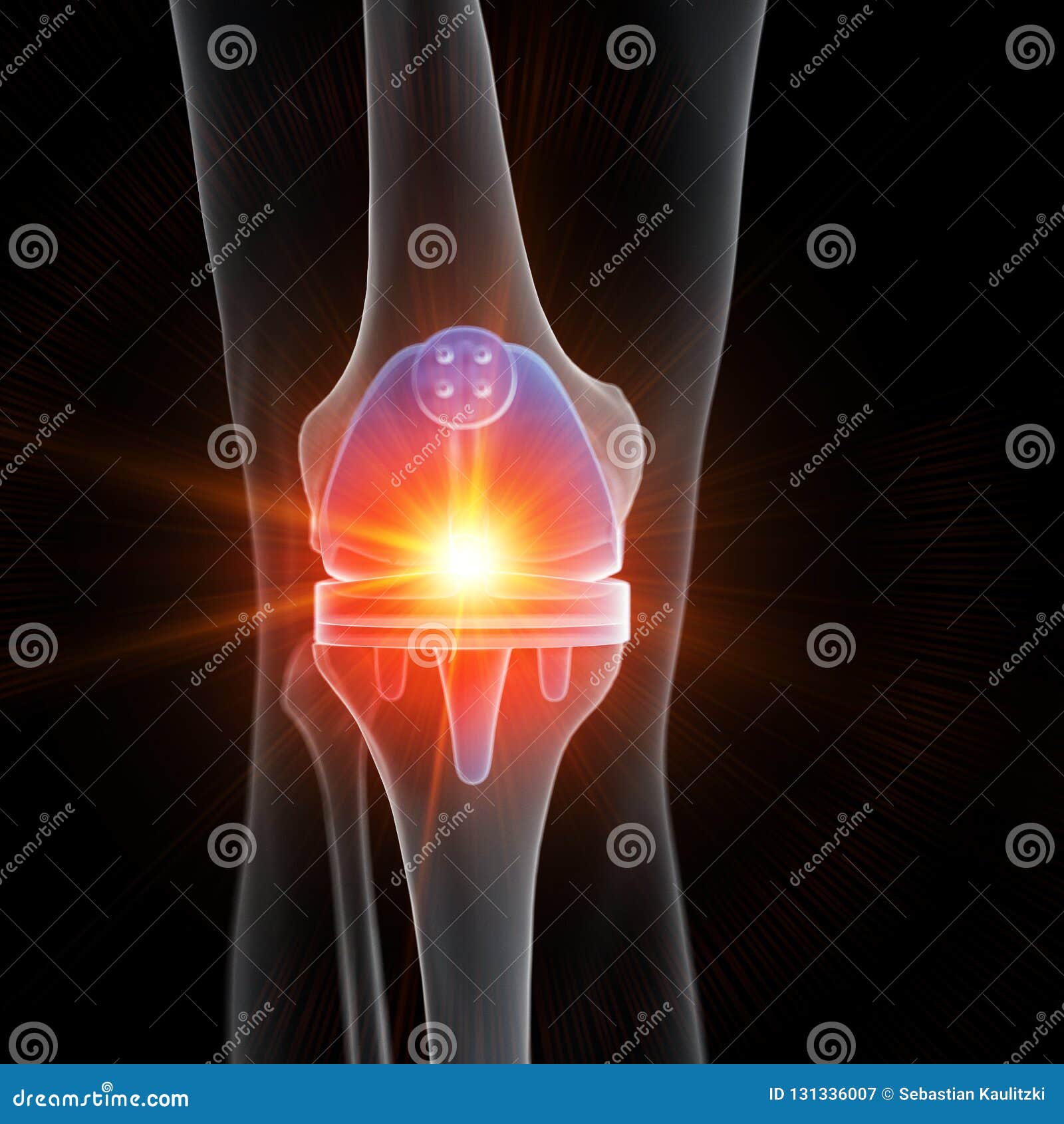 A knee replacement stock illustration. Illustration of body - 131336007