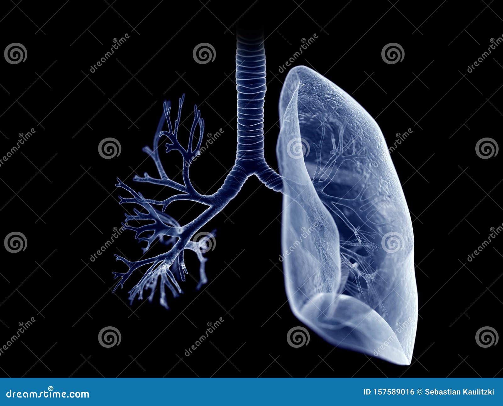 Lung And Bronchi With Cancer Stock Illustration | CartoonDealer.com ...