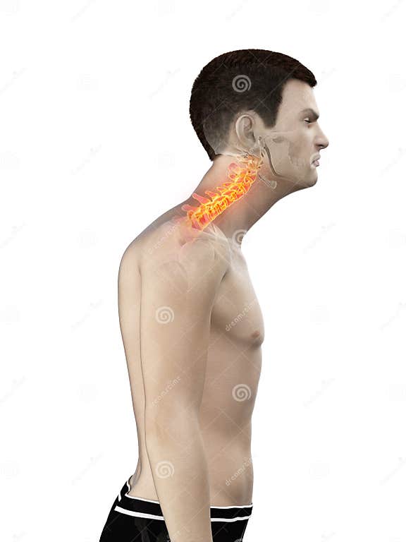 A forward head posture stock illustration. Illustration of skeletal ...