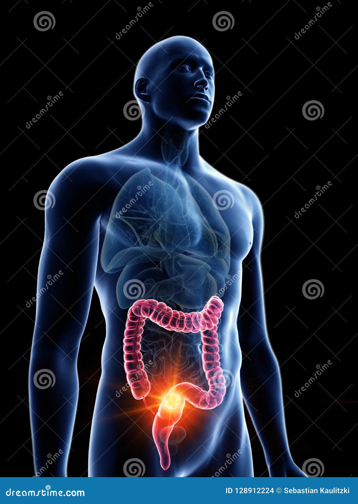 A Mans Colon Tumor Stock Illustration Illustration Of Male 128912224