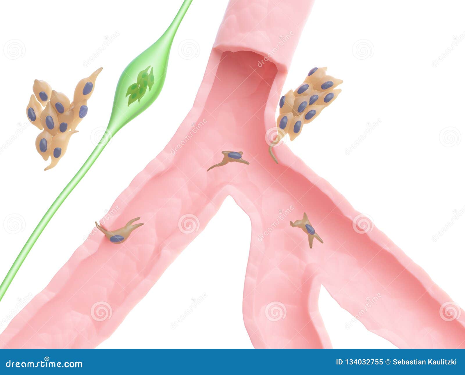 Metastasis Cartoons, Illustrations & Vector Stock Images - 3301 ...