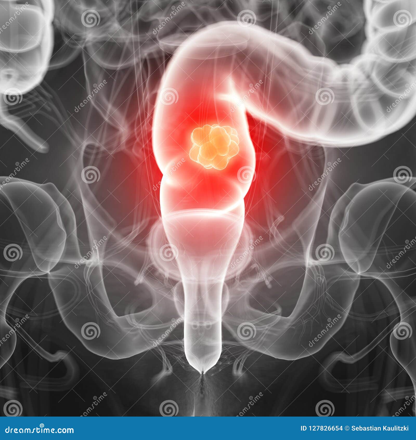 The Rectal Cancer Stock Illustration Illustration Of Cancer 127826654