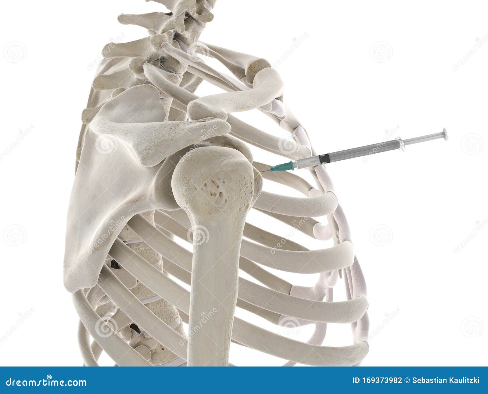A shoulder injection stock illustration. Illustration of accurate ...