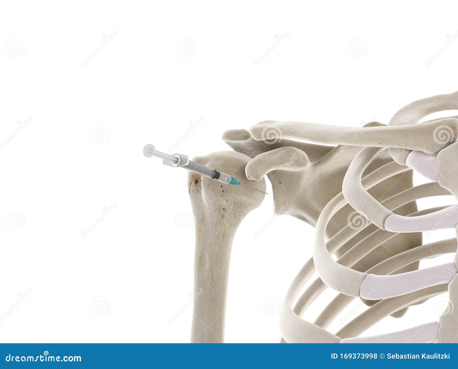A shoulder injection stock illustration. Illustration of injection ...