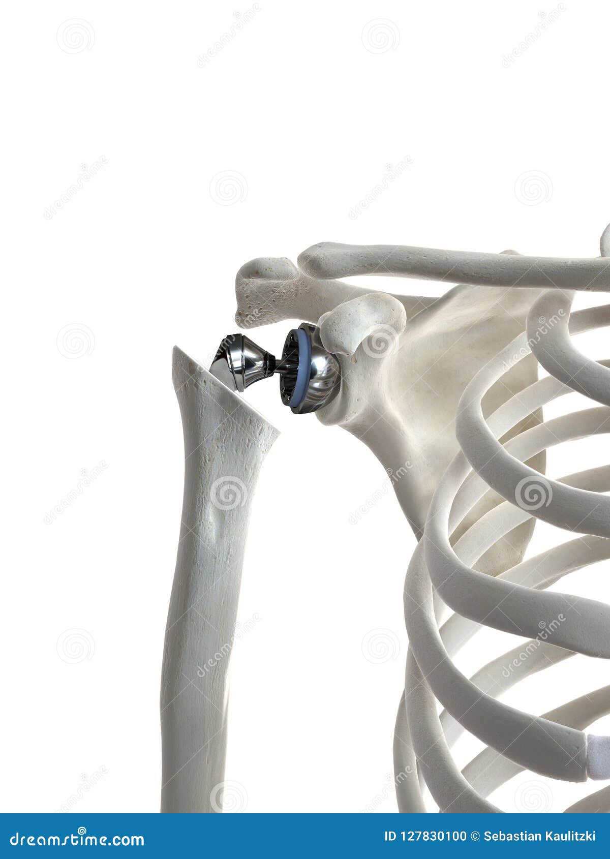 Shoulder Prosthesis, Vector Banner With Place For Text. Medical ...