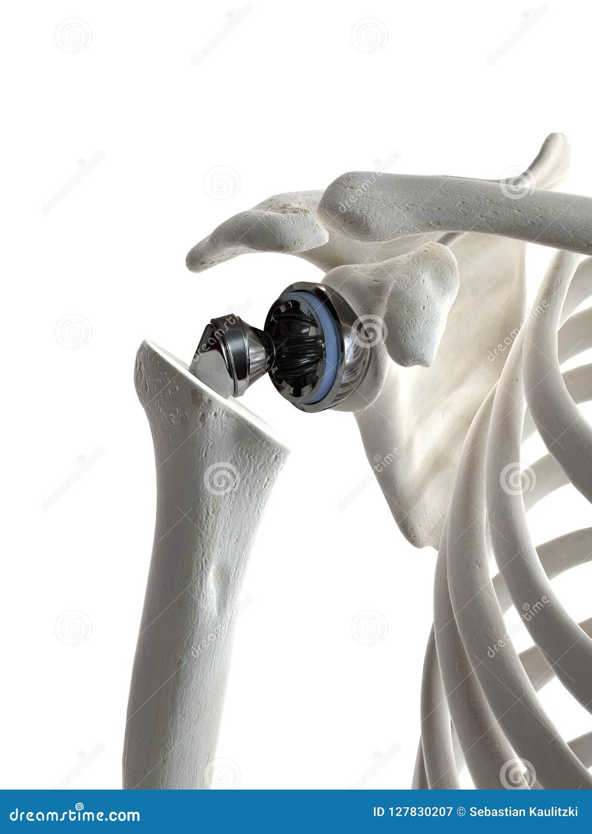 Shoulder Prosthesis, Vector Banner With Place For Text. Medical ...