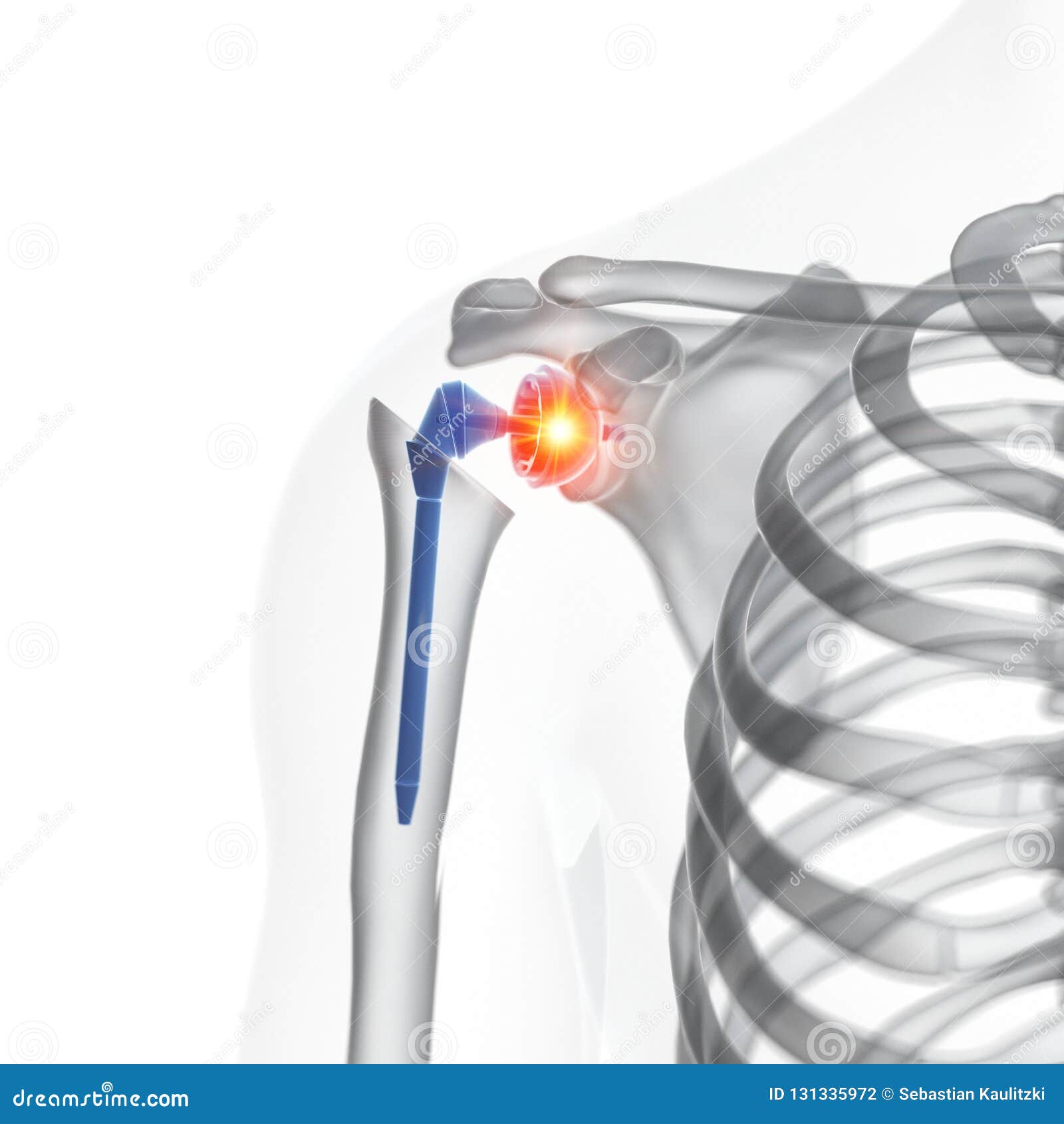 A shoulder replacement stock illustration. Illustration of anatomical ...