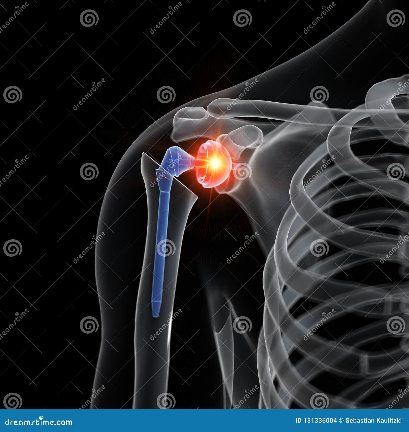 A shoulder replacement stock illustration. Illustration of medical ...