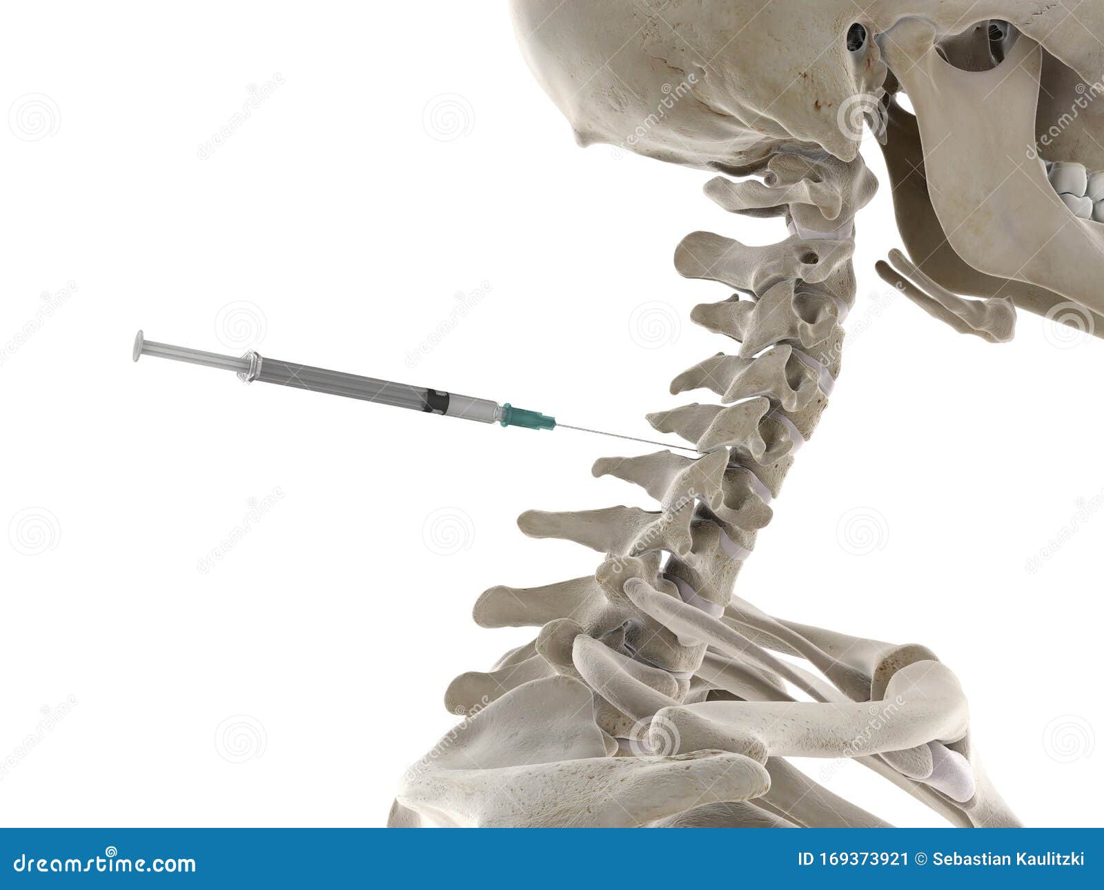 A spine injection stock illustration. Illustration of isolated - 169373921