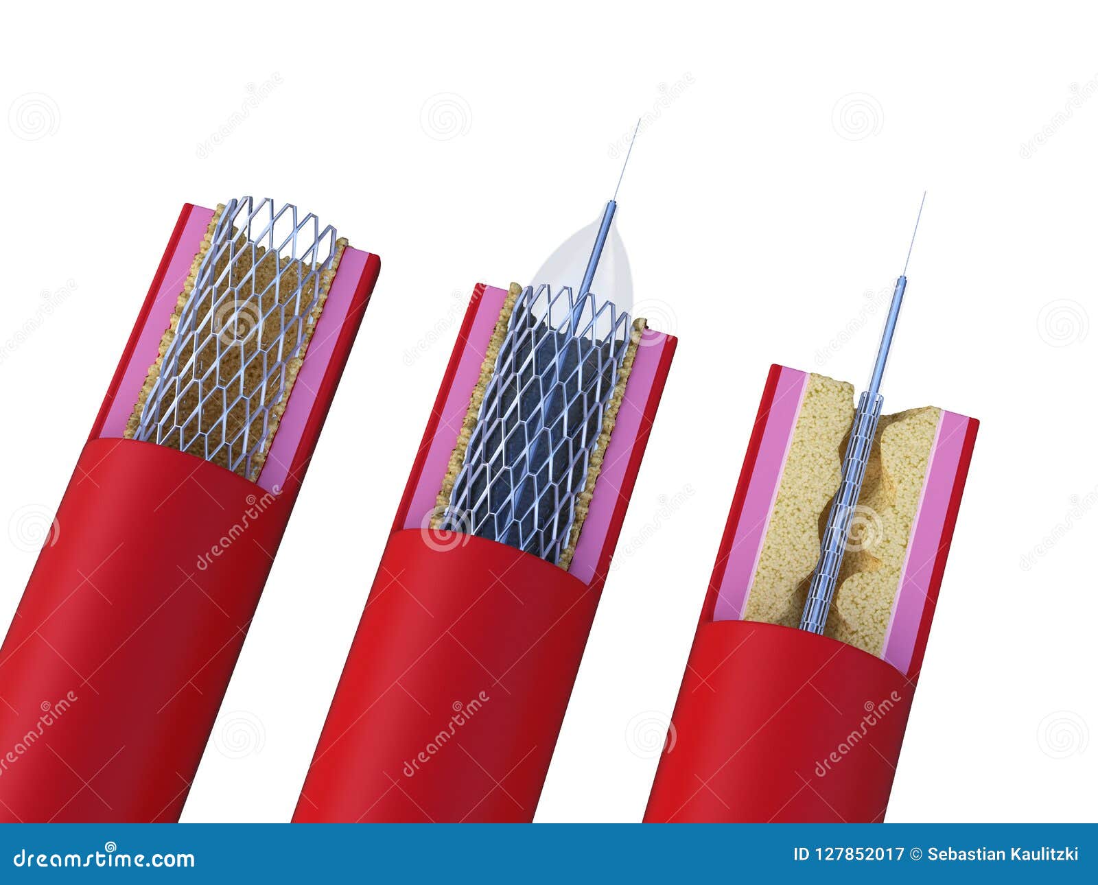Stent Placed In An Artery Royalty-Free Cartoon | CartoonDealer.com ...