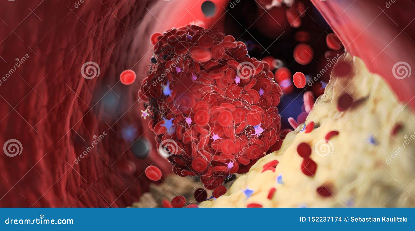 Thrombus Cartoons, Illustrations & Vector Stock Images - 1013 Pictures ...