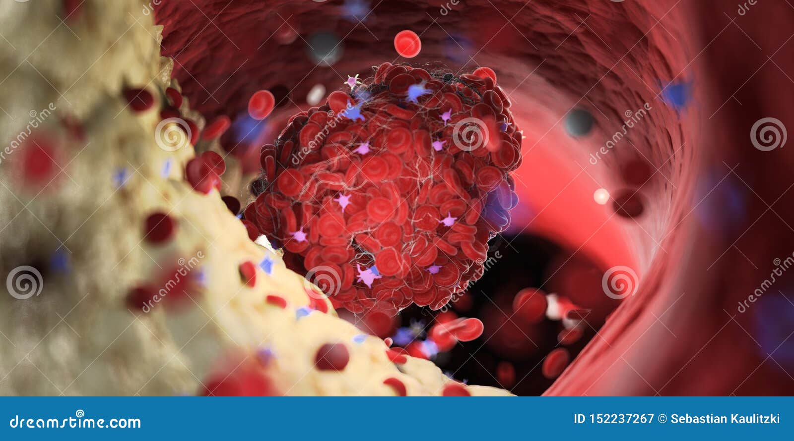 Thrombus In Bloodstream, Blood Clot With Activated Platelets And Fibrin ...
