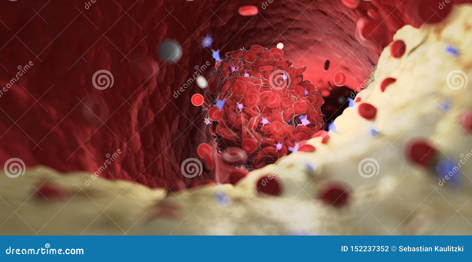 Thrombus In Bloodstream, Blood Clot With Activated Platelets And Fibrin ...