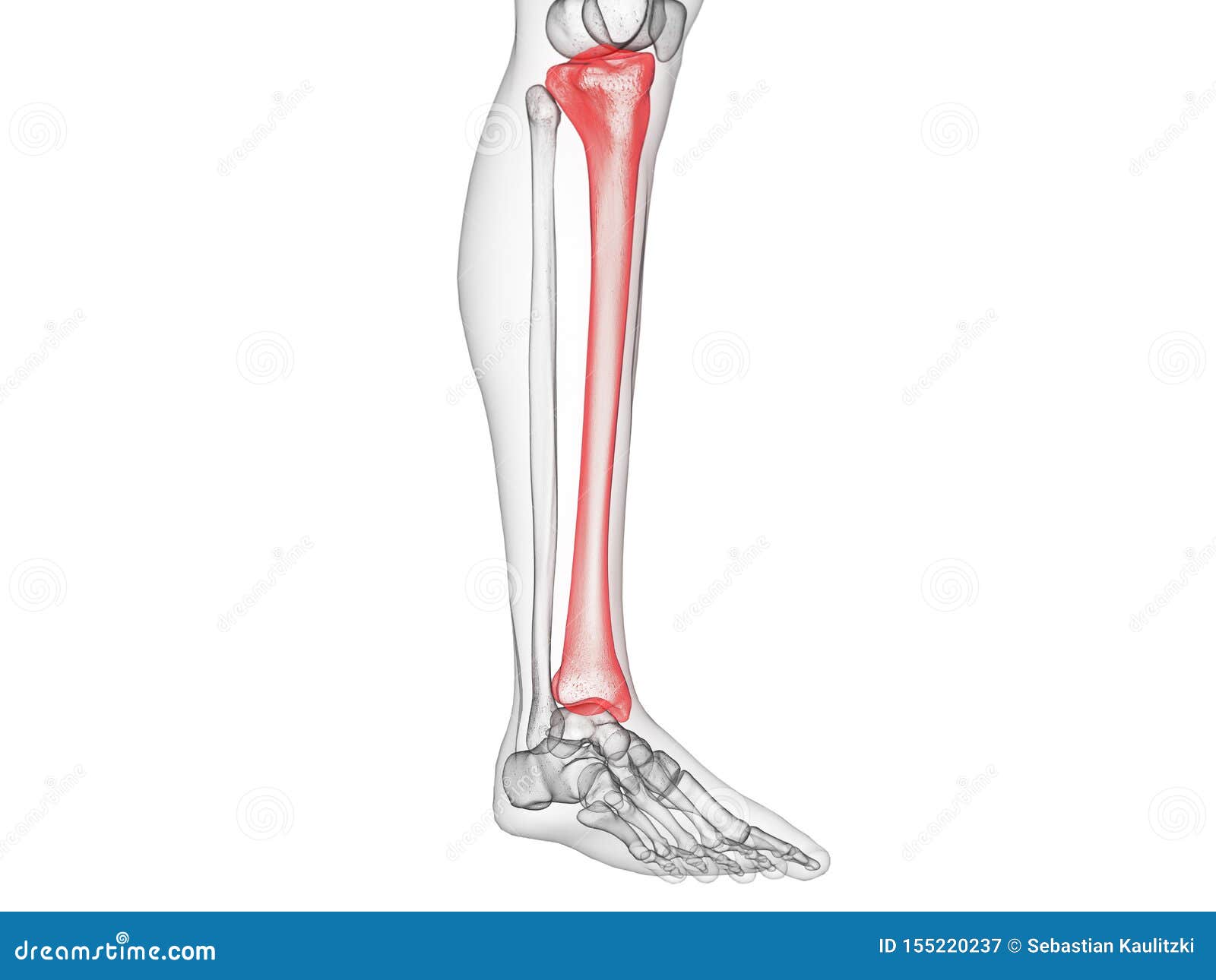 Tibia Bone Osteomyelitis Cartoon Vector | CartoonDealer.com #291792065