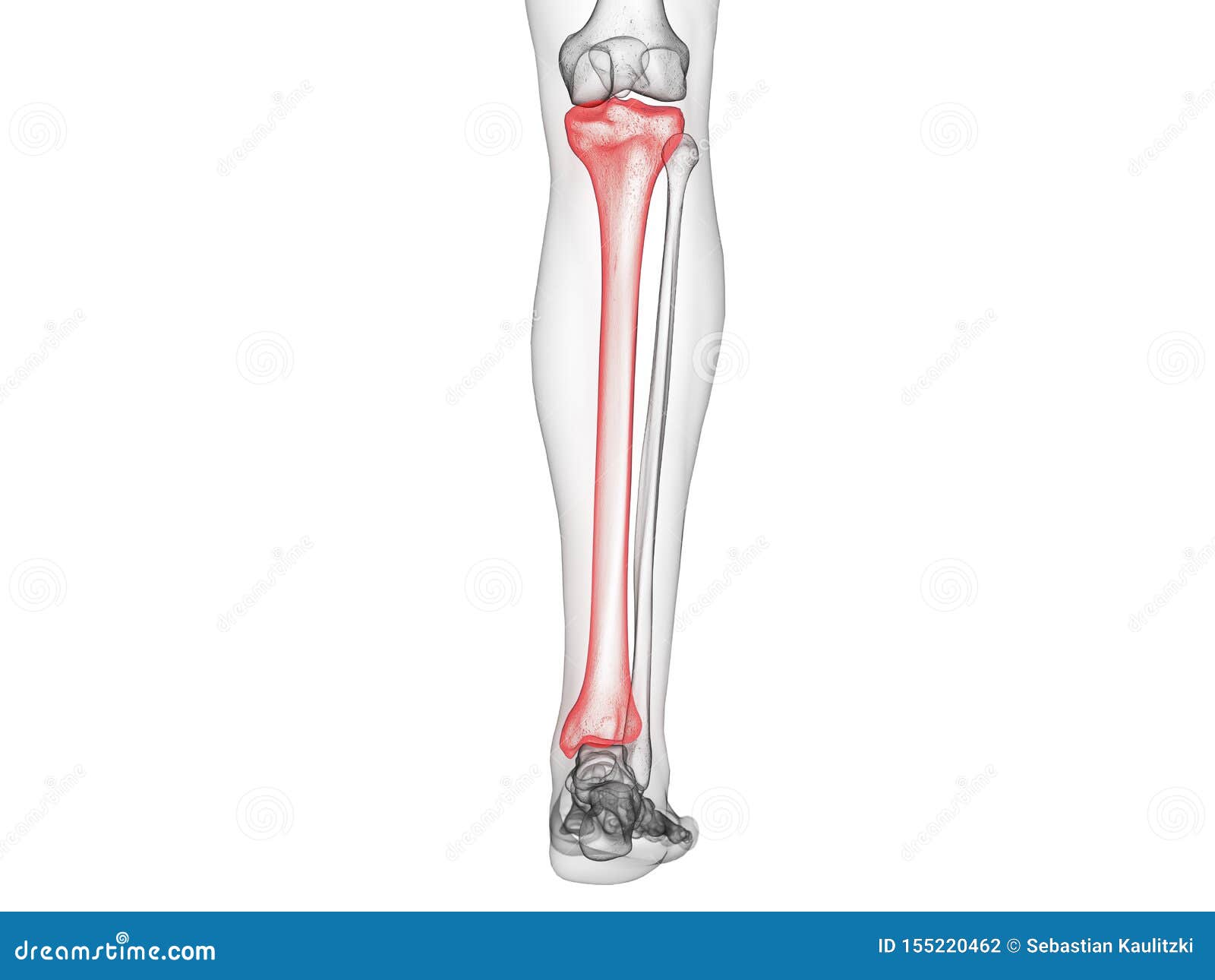 Tibia Bone Osteomyelitis Cartoon Vector | CartoonDealer.com #291529627