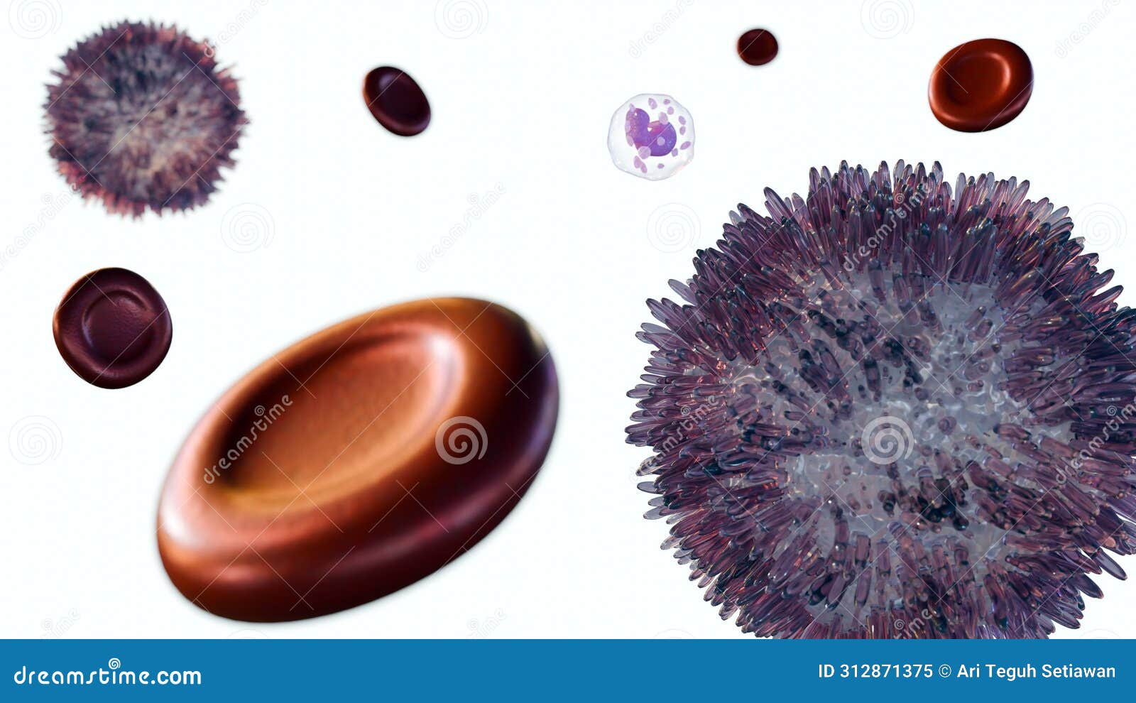 Hairy Cell Leukemia (HCL) or Known As Leukemic Reticuloendotheliosis ...