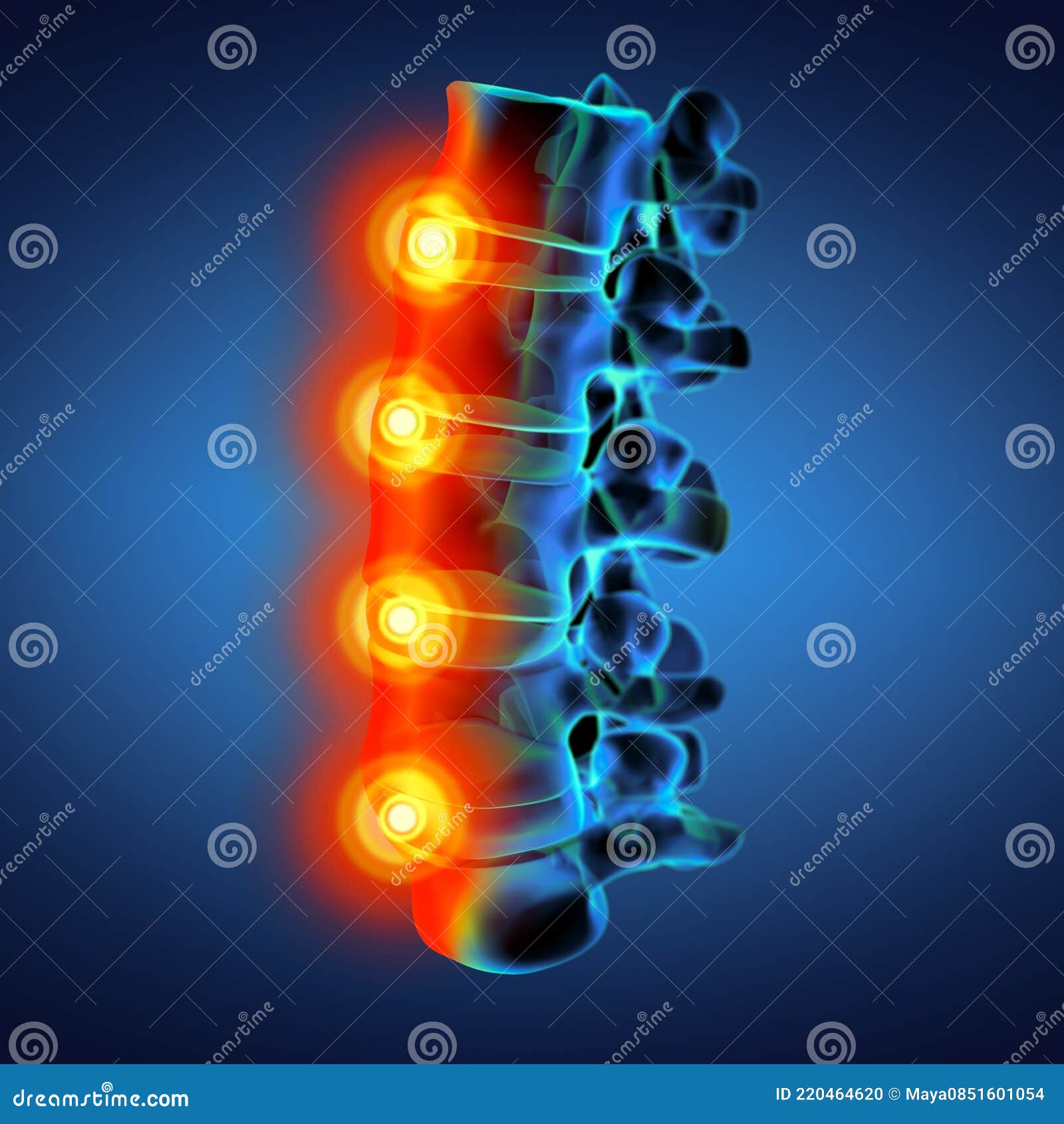 3D Rendering Of The Slipped Disc (prolapsed Disc) With Labels - Human ...