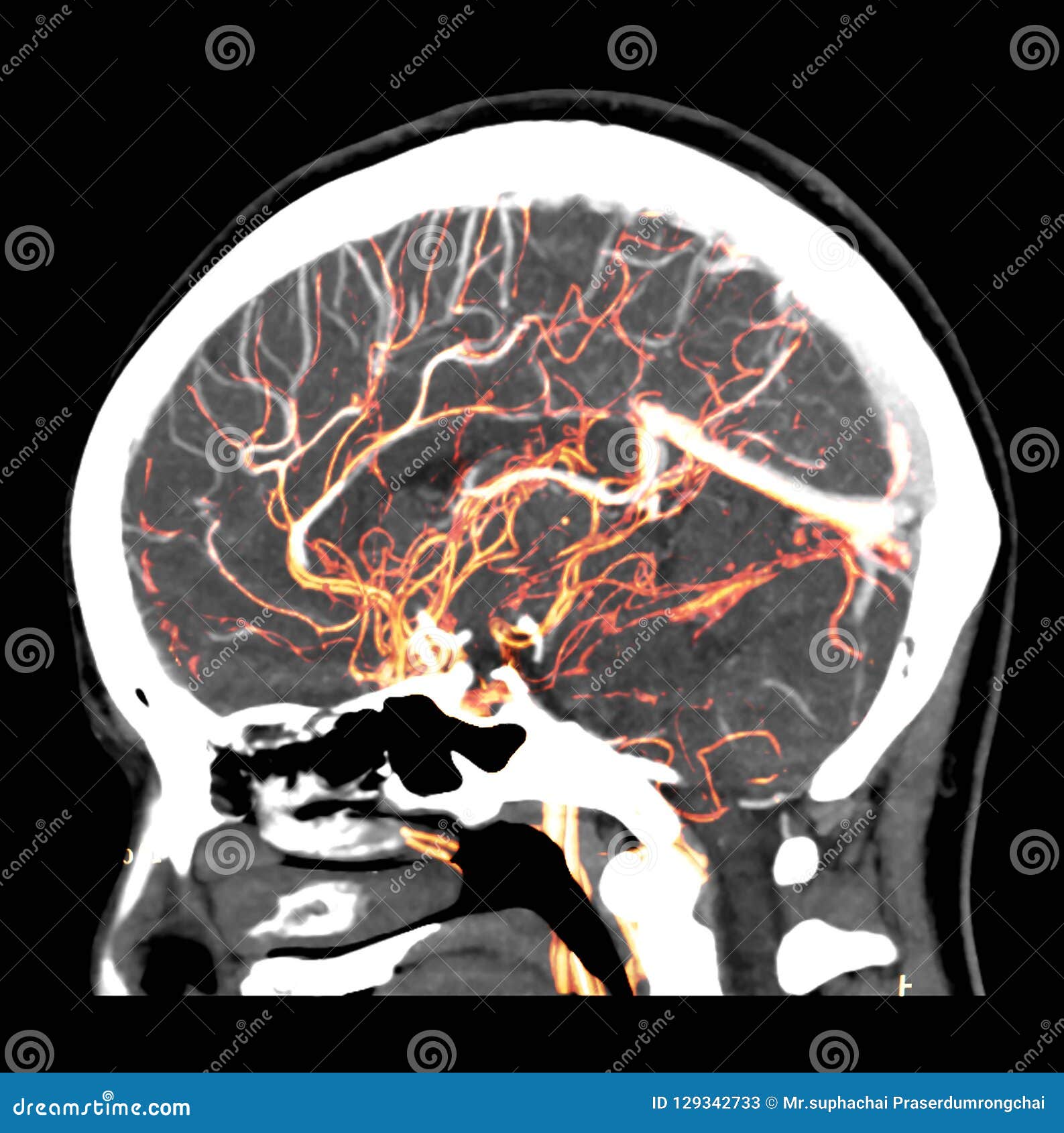3D Rendering Image Of The Human Brain Showing Normal Arteries In The ...