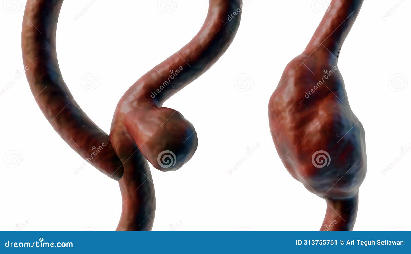 Fusiform Aneurysm, Bulges Out Equally In All Directions Stock Image ...